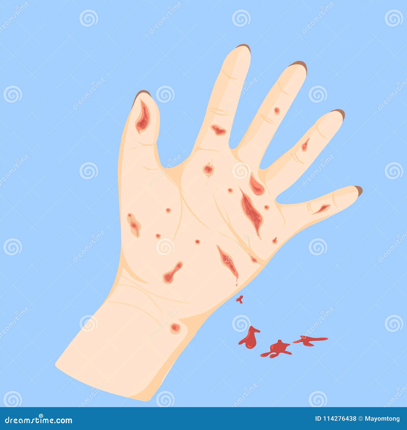 Wounded hand stock vector. Illustration of wound, flattened - 114276438