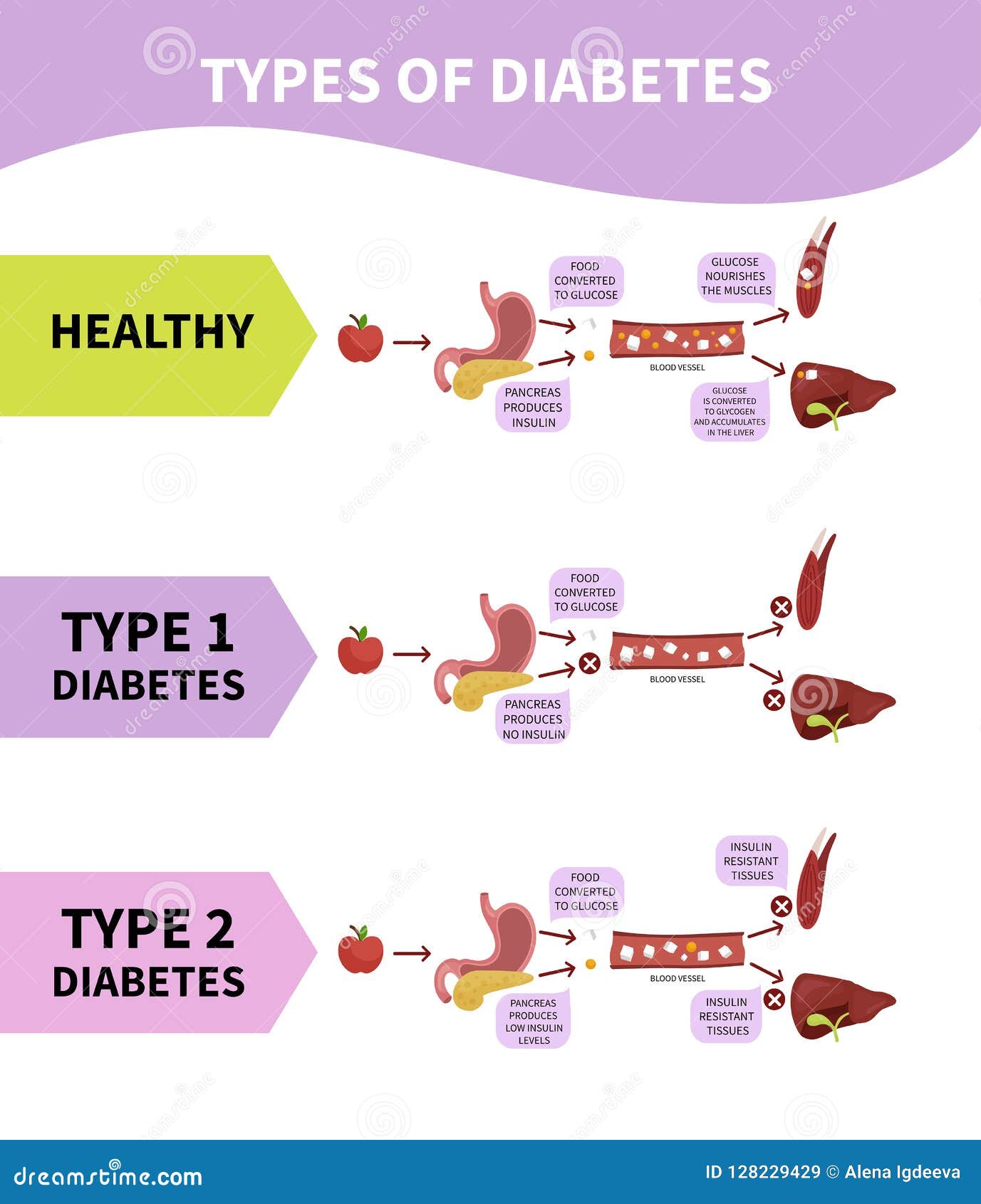 Infographic Of Diabetes Symptoms And Signs In A Patient With DM Type 1 ...
