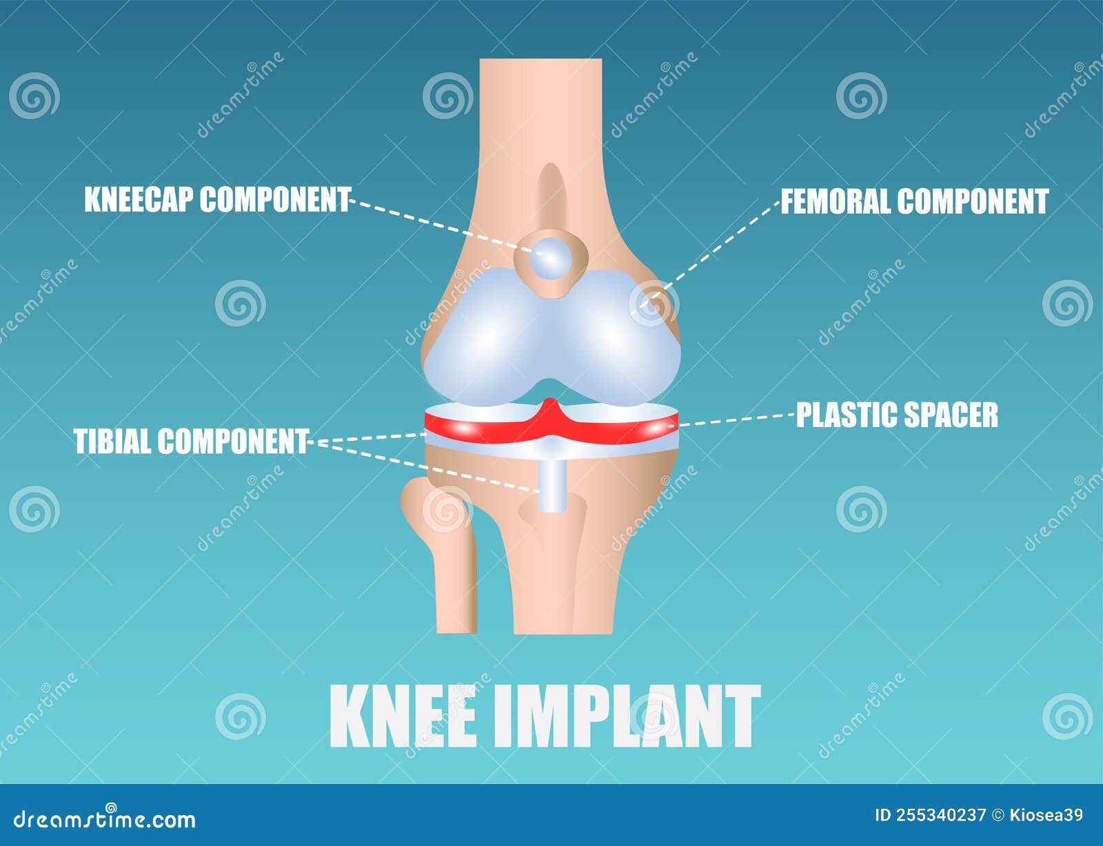 Vector of a knee implant stock vector. Illustration of poster - 255340237