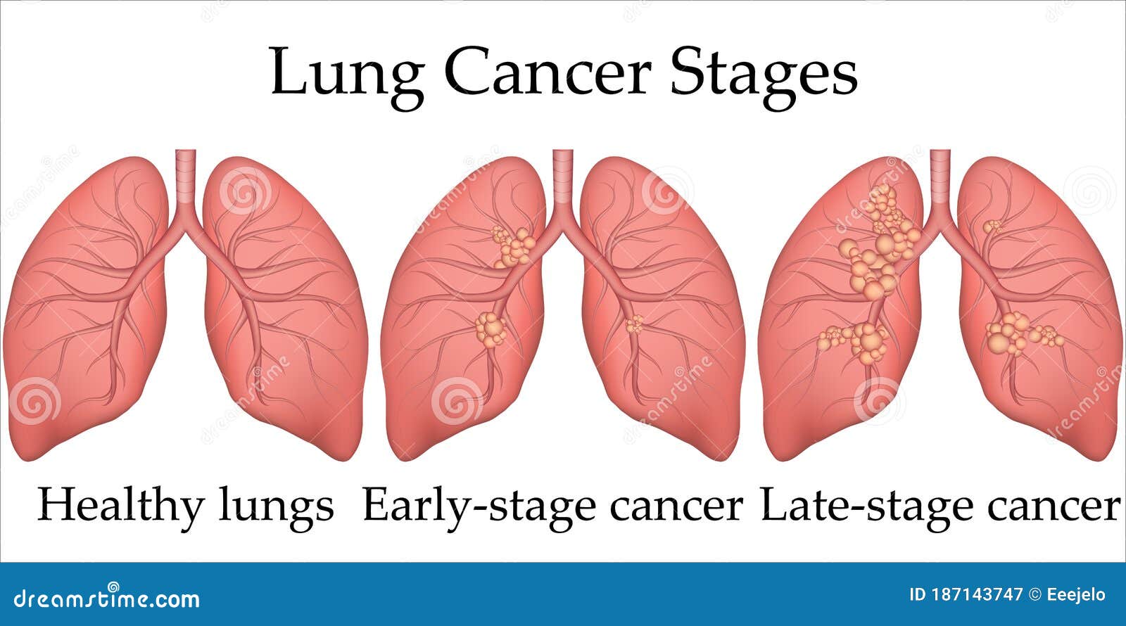 Vector Medical Illustration Of Human Lung Cancer Development Process ... Vector Medical Illustration Of Human Lung Cancer Development Process ...
