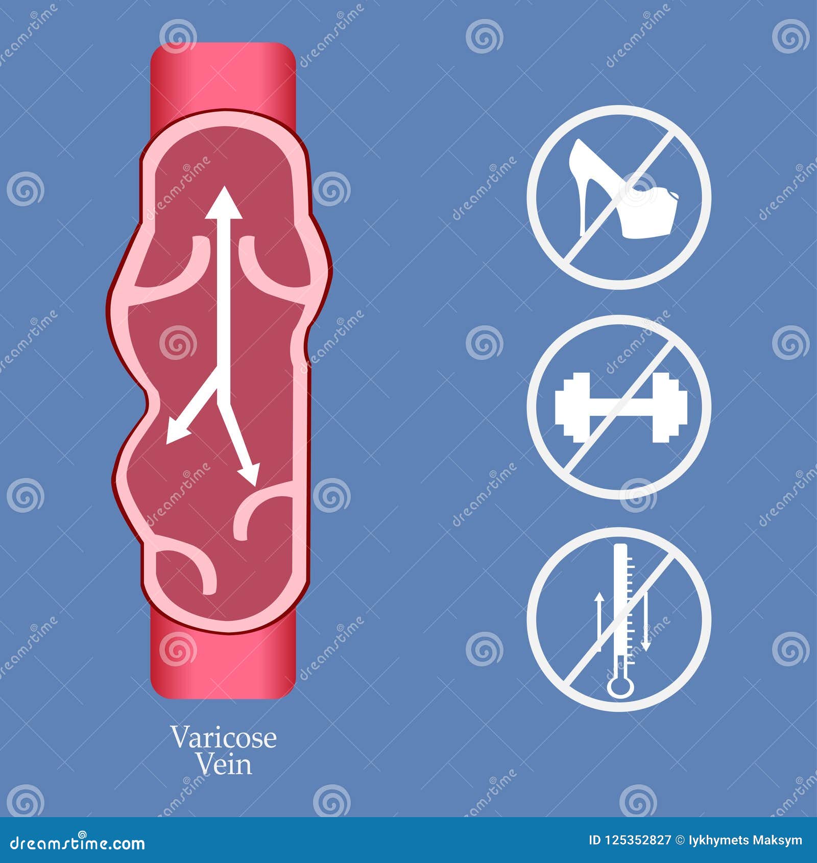 Vector Varicose Vein. Varicose Vein Stock Illustration - Illustration ...