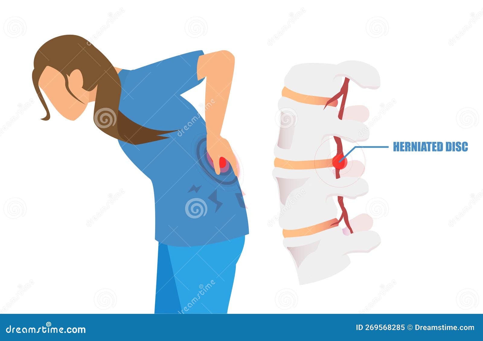Sciatica As Symptom From Herniated Disc And Spinal Nerve Outline ... Sciatica As Symptom From Herniated Disc And Spinal Nerve Outline ...