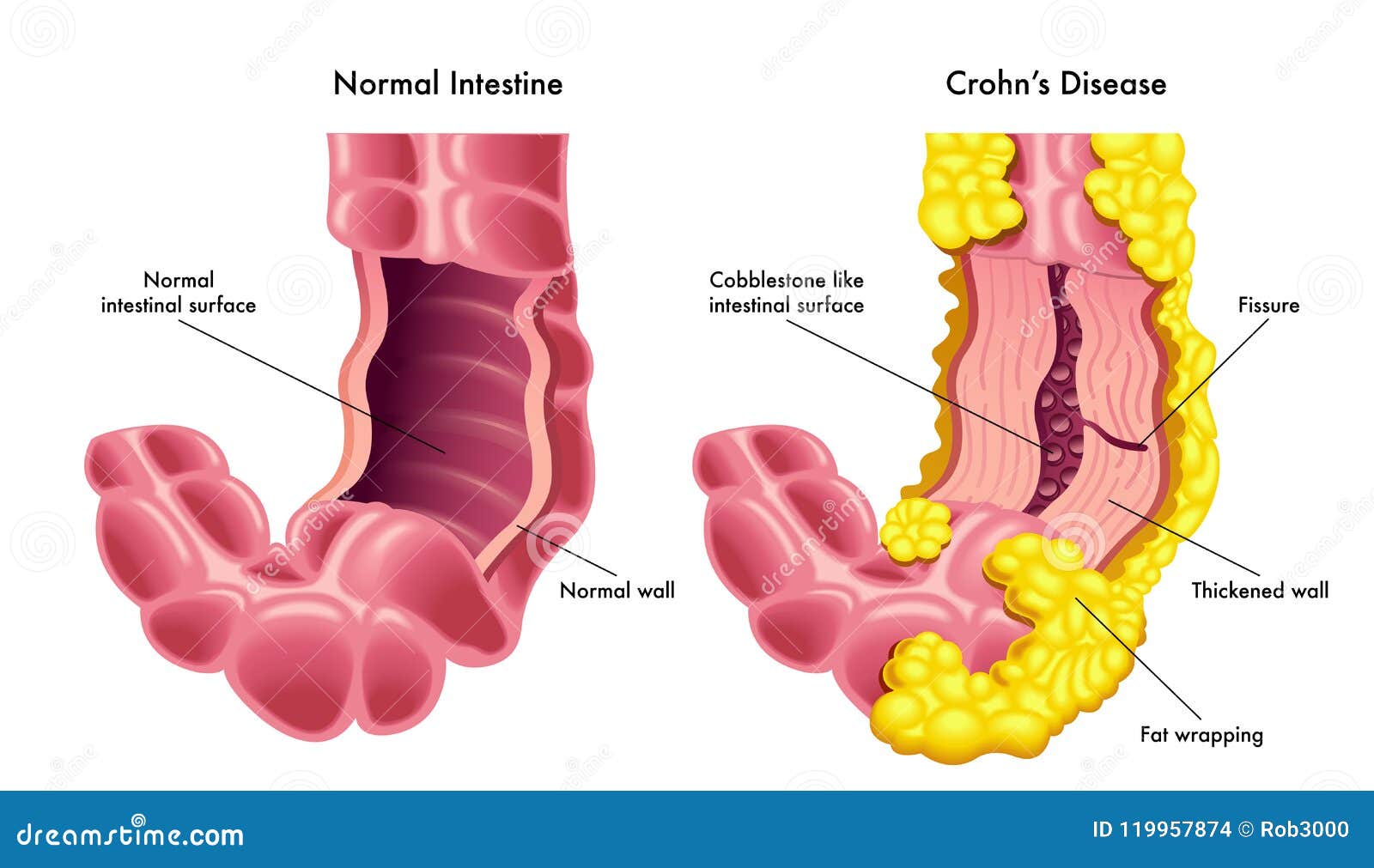 Vectorillustratie Van Darm Met Crohns-ziekte Vector Illustratie ...