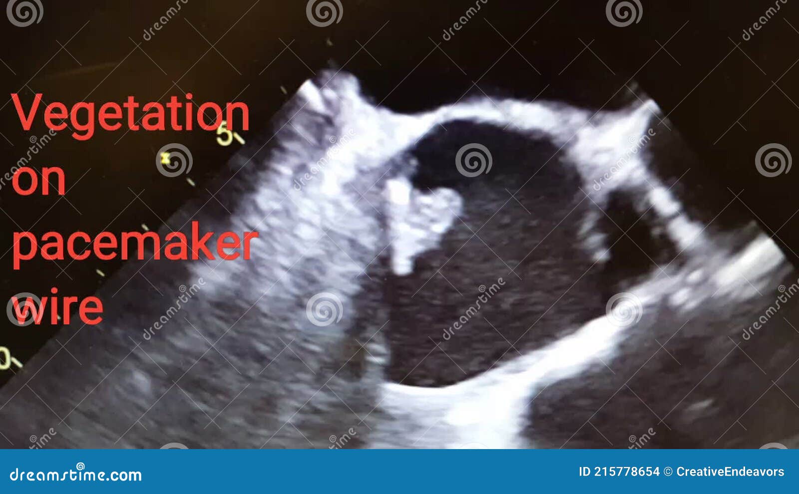 Vegetation on Infected Pacemaker Wire - Endocarditis Patient Stock ...