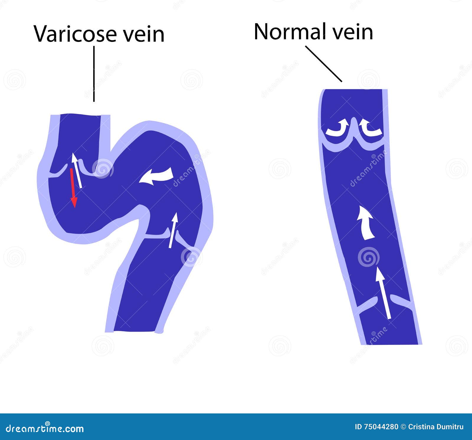 Veia Normal E Veia Varicosa Ilustração Stock - Ilustração de biologia ...
