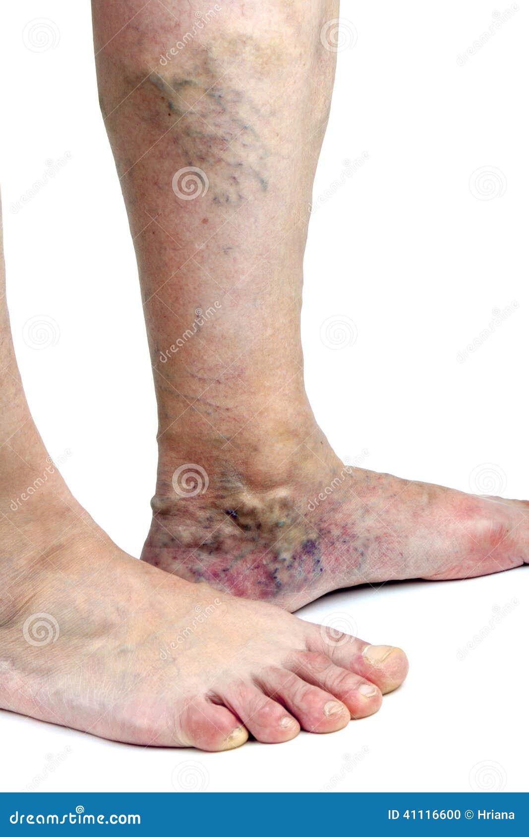 Veias varicosas foto de stock. Imagem de membros, menor - 41116600