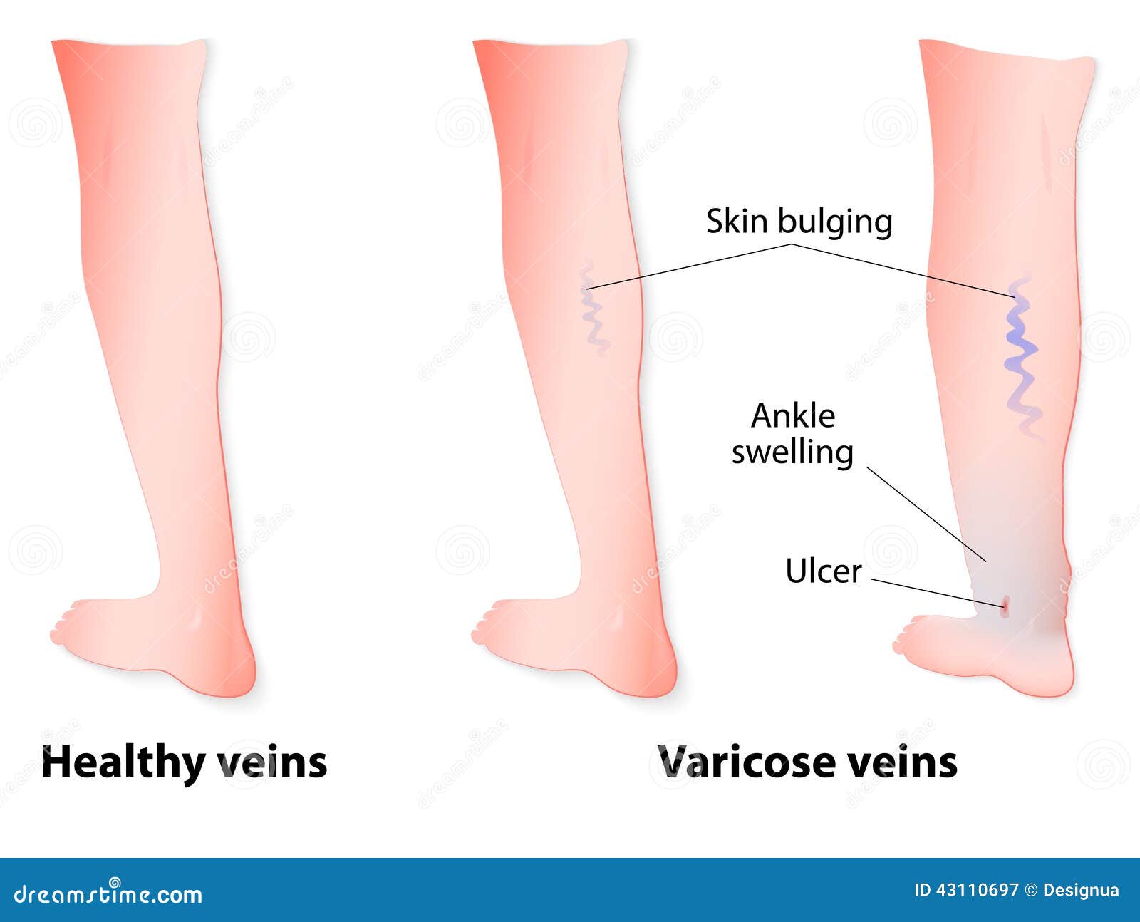 Veias varicosas ilustração do vetor. Ilustração de cirurgia - 43110697