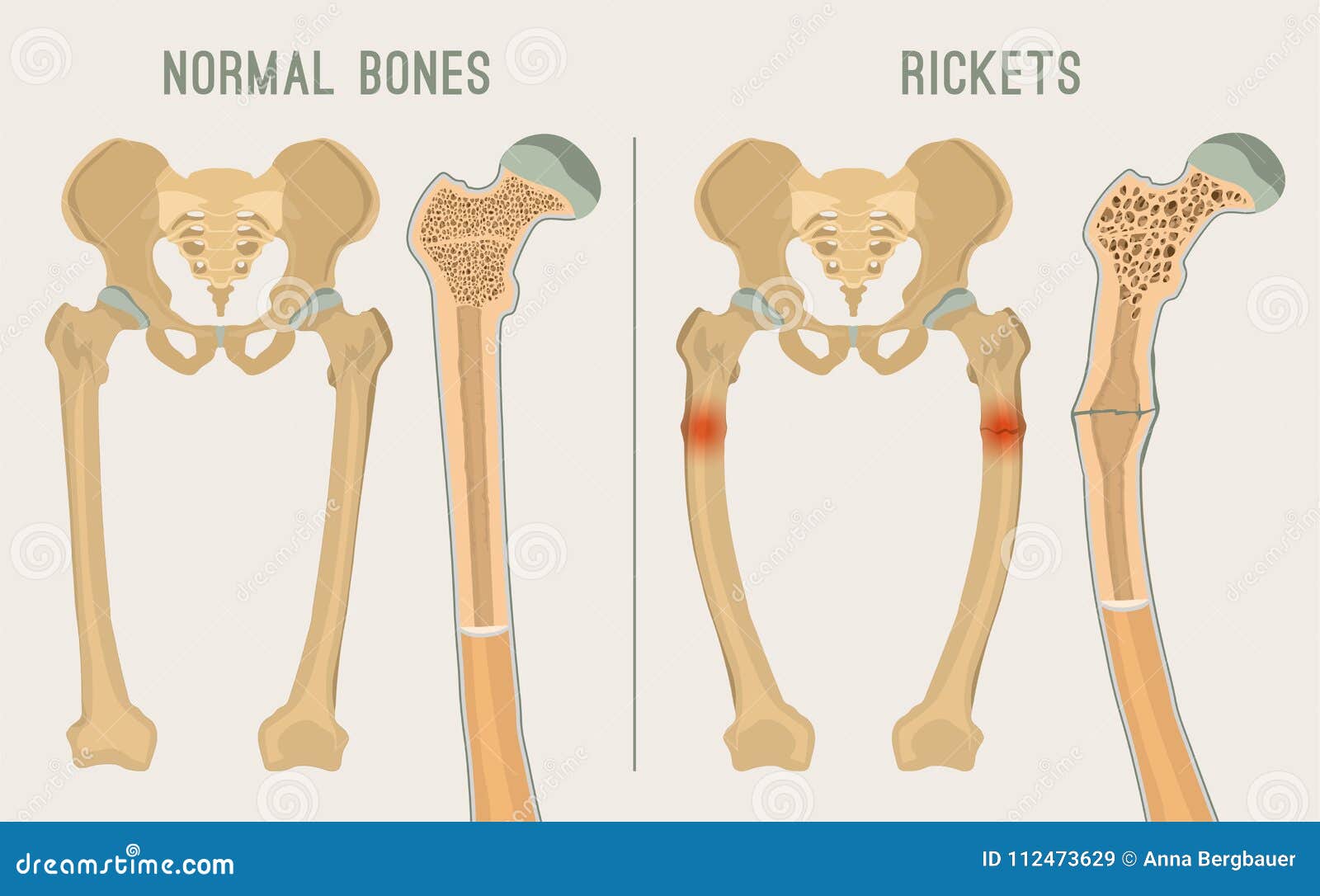 Vektor-Rachitis-Entwurf vektor abbildung. Illustration von anatomie ...