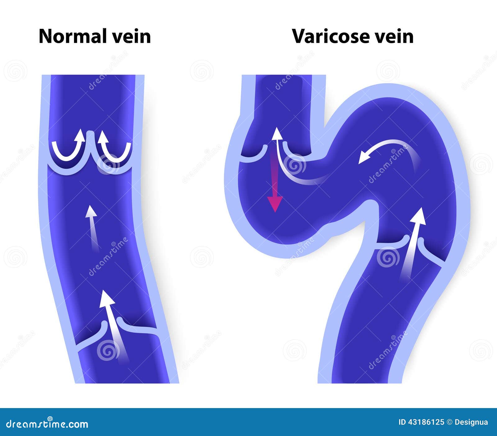 Vena normal y variz ilustración del vector. Ilustración de movimiento ...