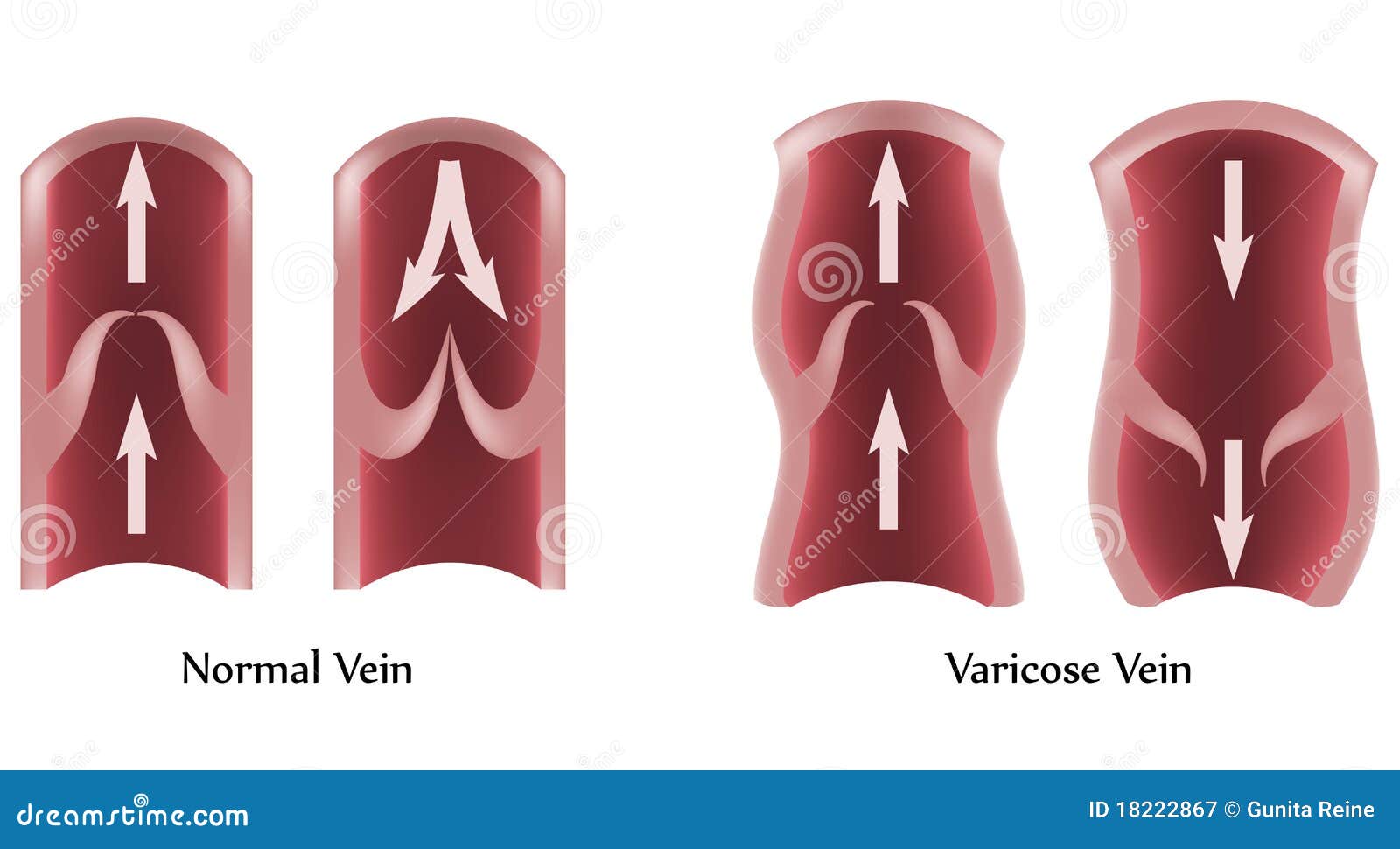 Vene Varicose E Vene Normali Illustrazione Vettoriale - Illustrazione ...