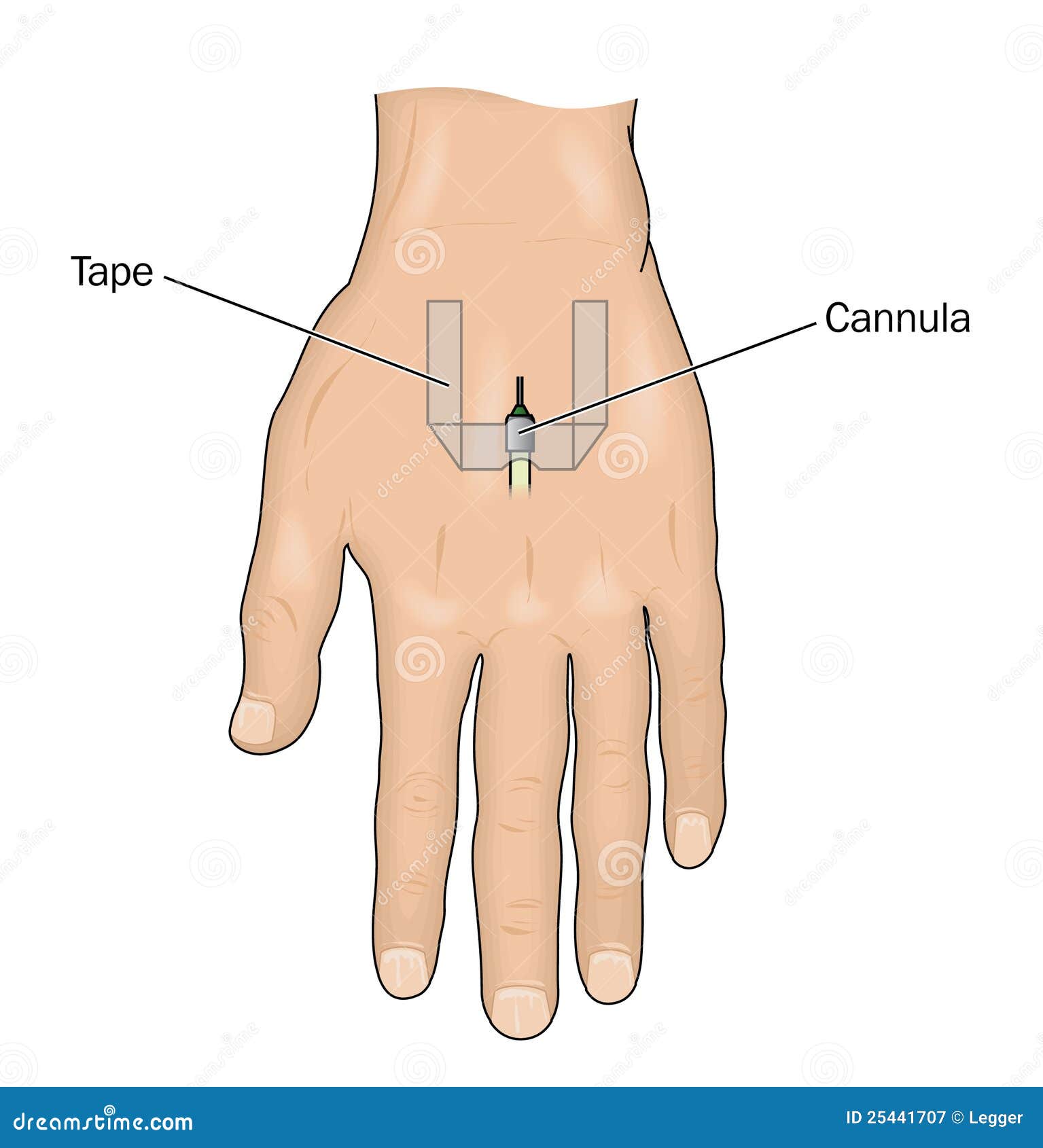 Venous cannula stock illustration. Illustration of biology - 25441707
