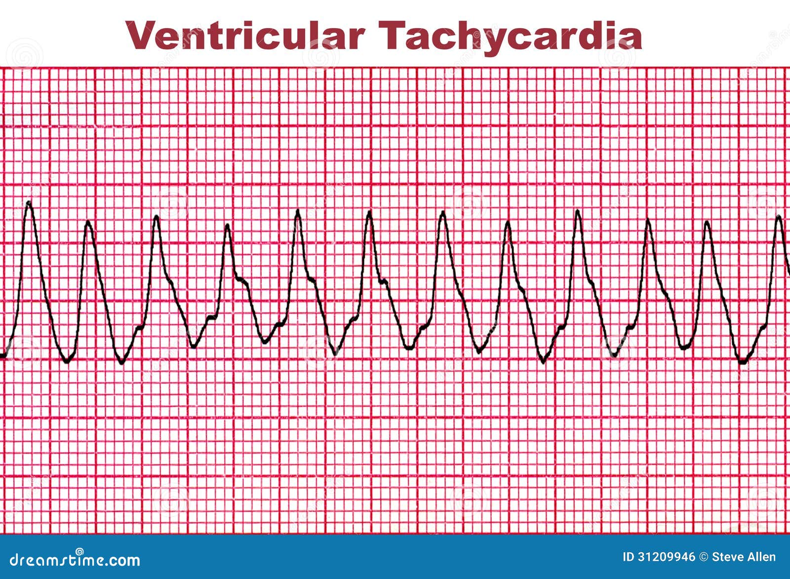 Ventriculaire Hartkloppingen - Dodelijke Hartaritmie Stock Illustratie ...