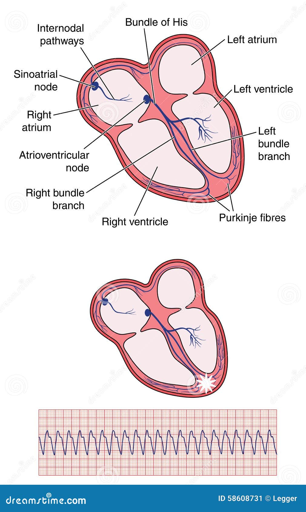 Ventriculaire Hartkloppingen Van Hart Vector Illustratie - Illustration ...