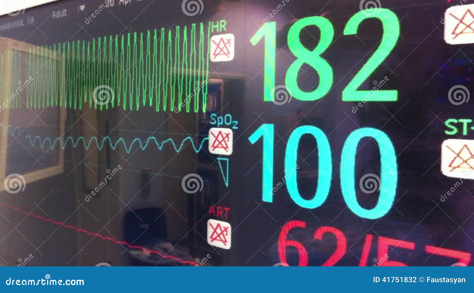 Ventricular Fibrillation Monitor
