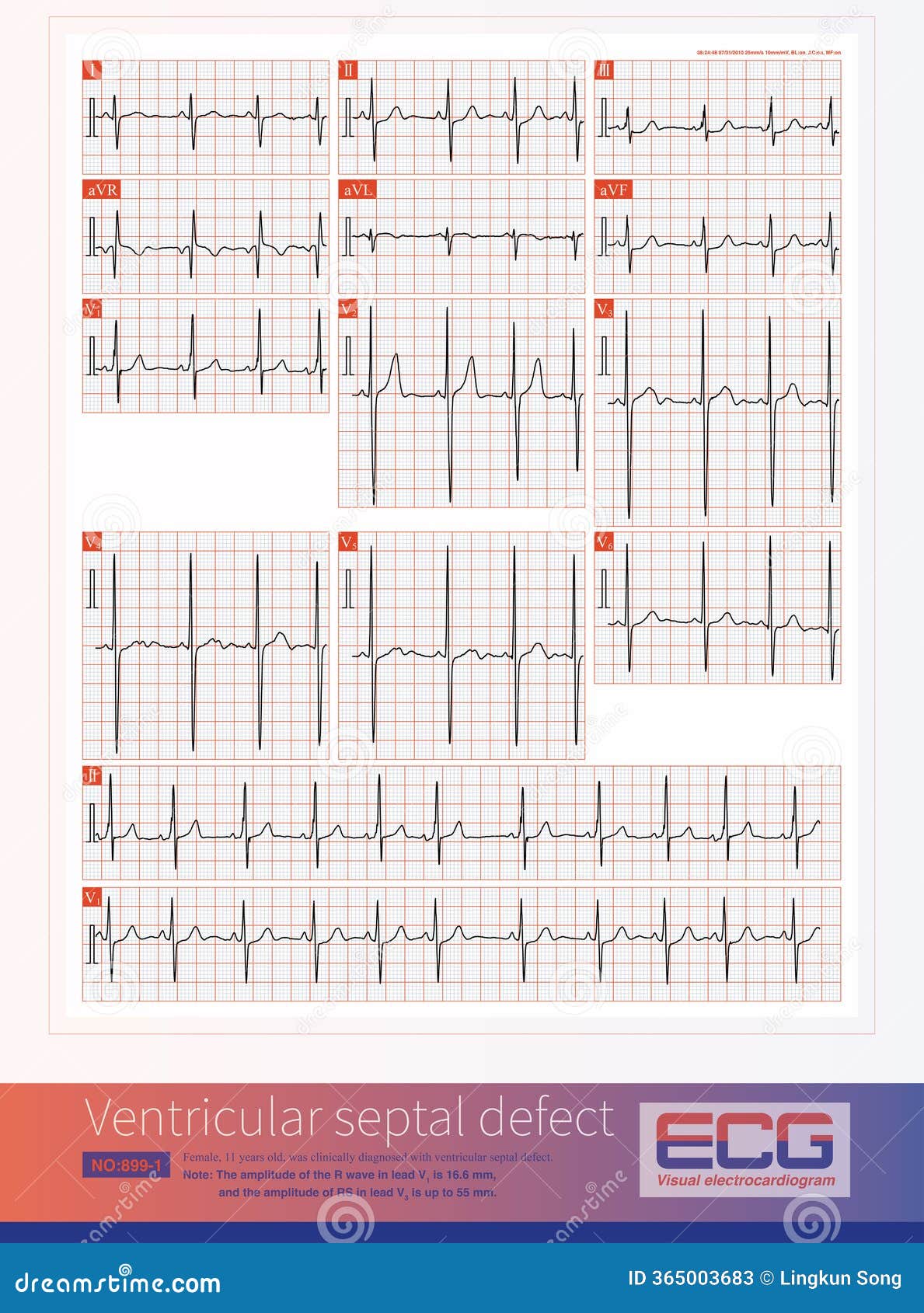 Ventricular Septal Defect Ecg Ventricular Septal Defect (VSD)