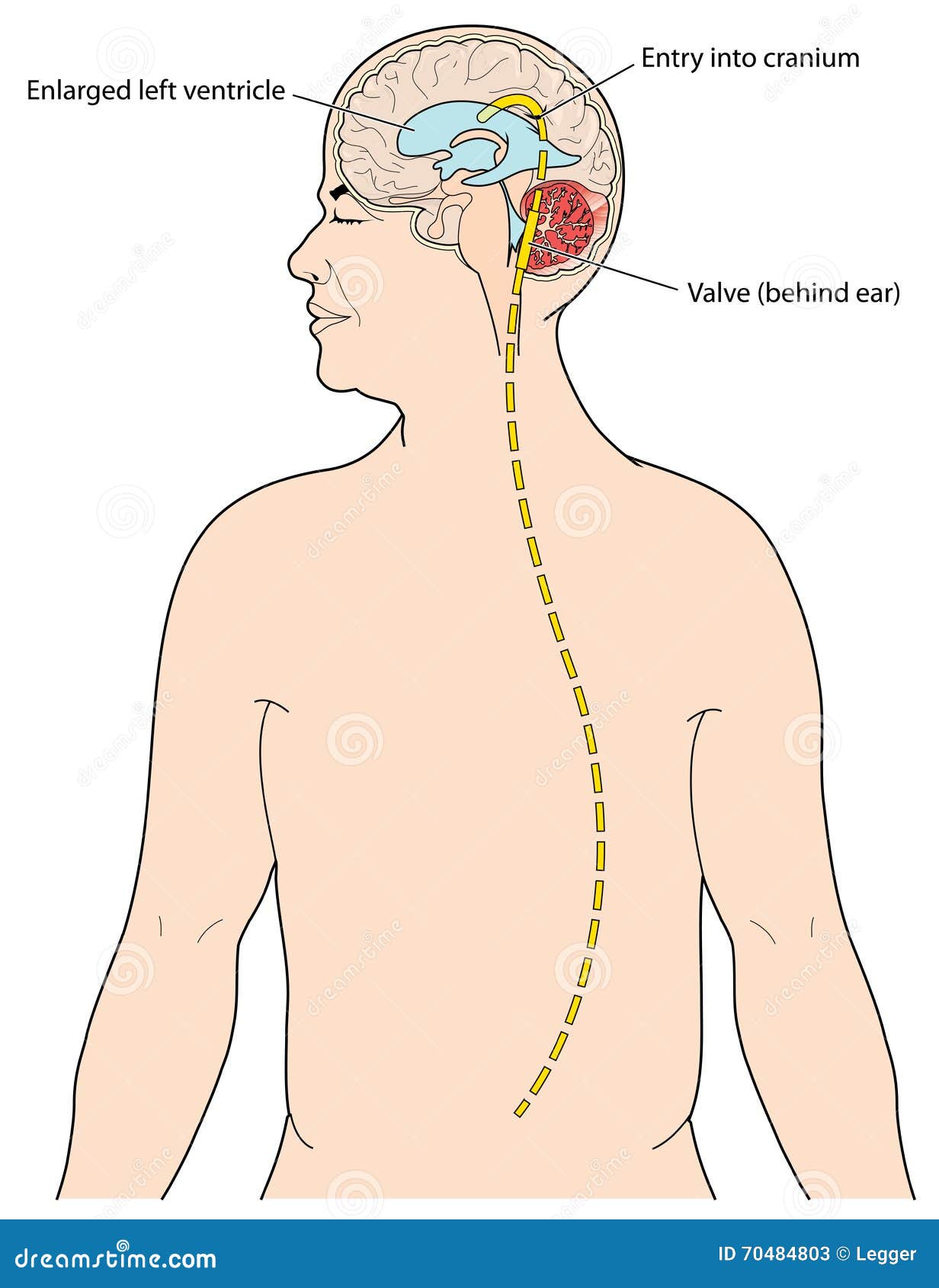 Ventriculoperitoneal Clipart And Illustrations