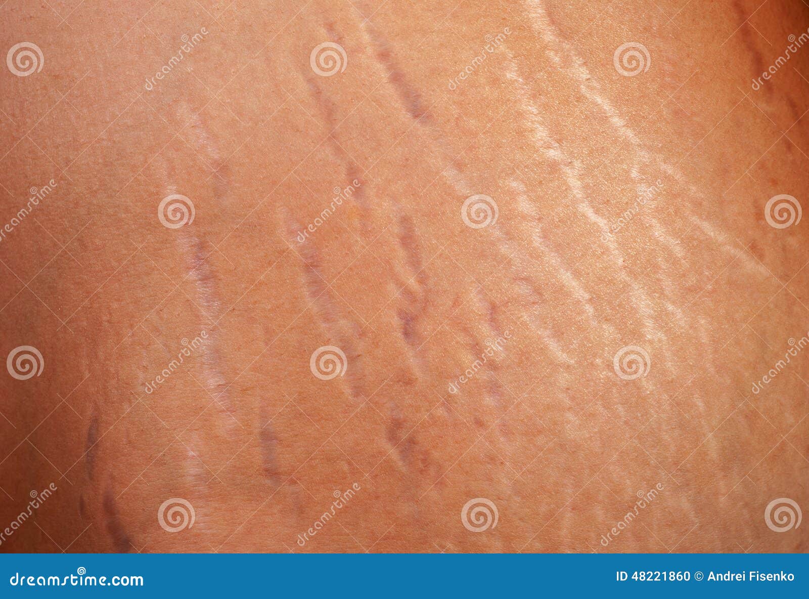 Vergetures sur le corps photo stock. Image du étirement - 48221860