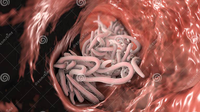 Vermes Parasitas No Lúmen Do Intestino Ilustração Stock - Ilustração de ... Vermes Parasitas No Lúmen Do Intestino Ilustração Stock - Ilustração de ...