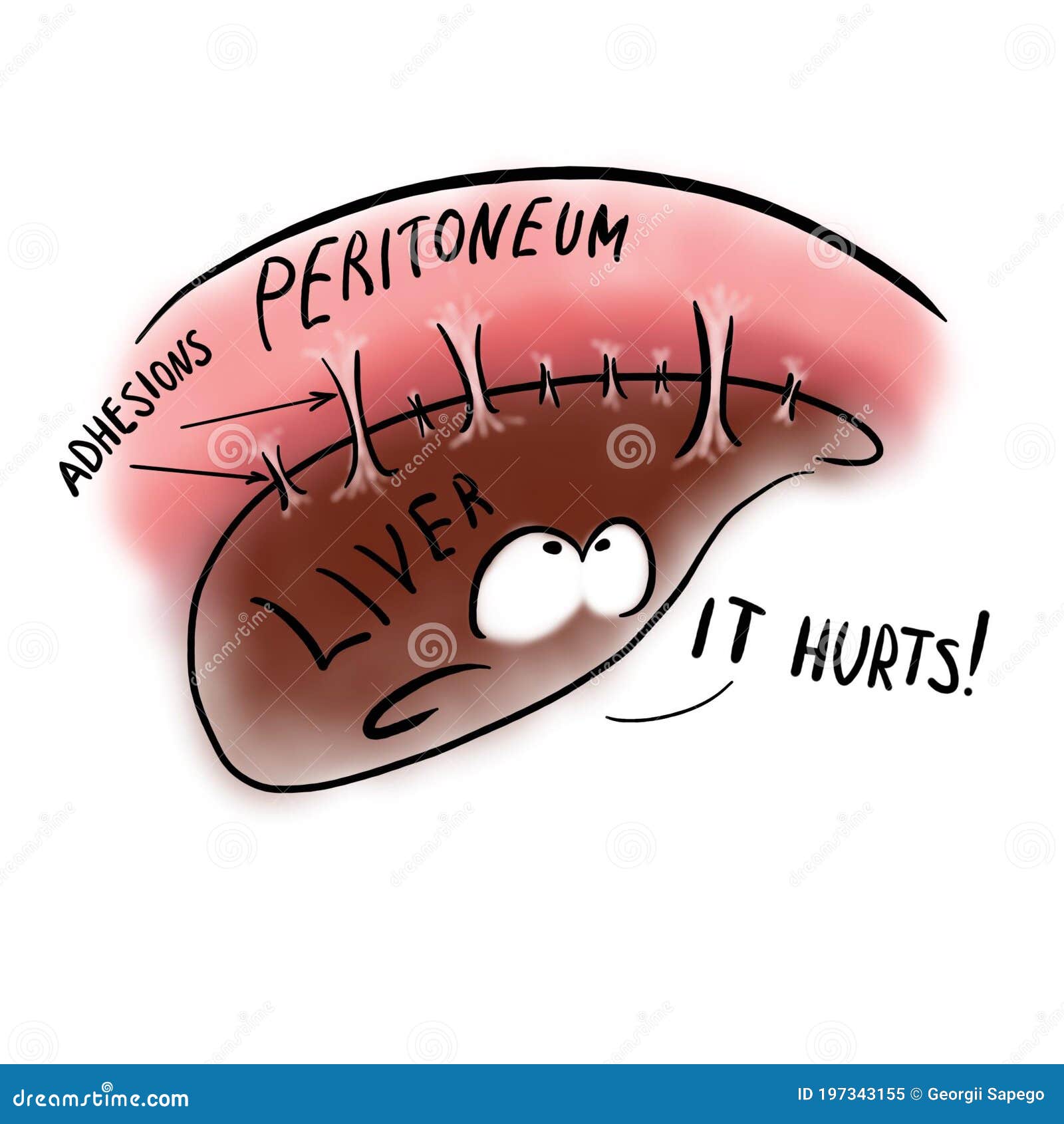 Verminderde Lever En Adhesie Aan Het Peritoneum Stock Illustratie ...