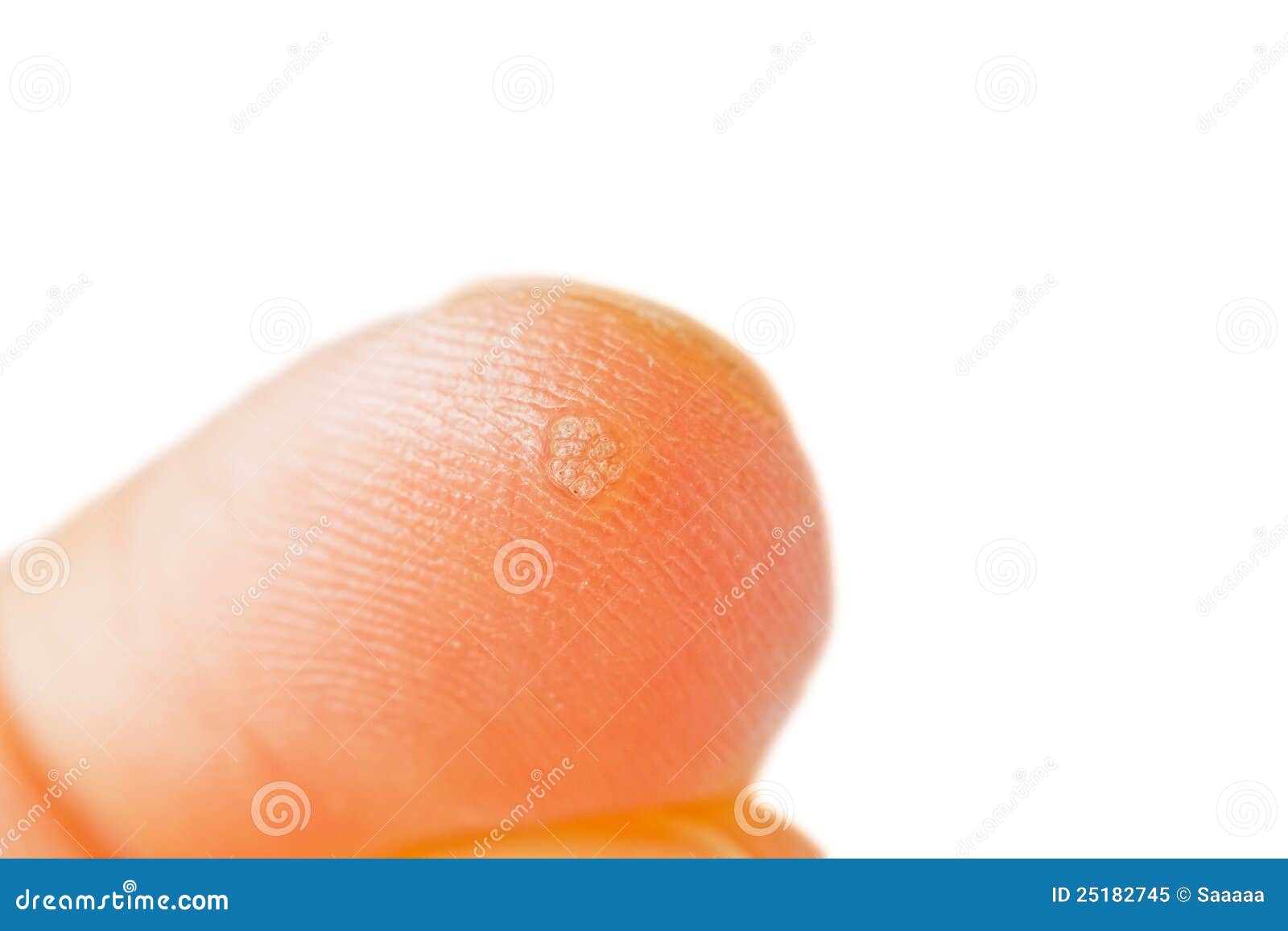 Verruca Formation Stock Image | CartoonDealer.com #25182745