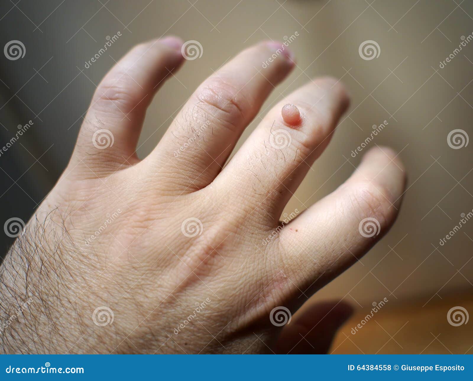 Verruca Sul Dito Della Mano Fotografia Stock - Immagine di medico ...