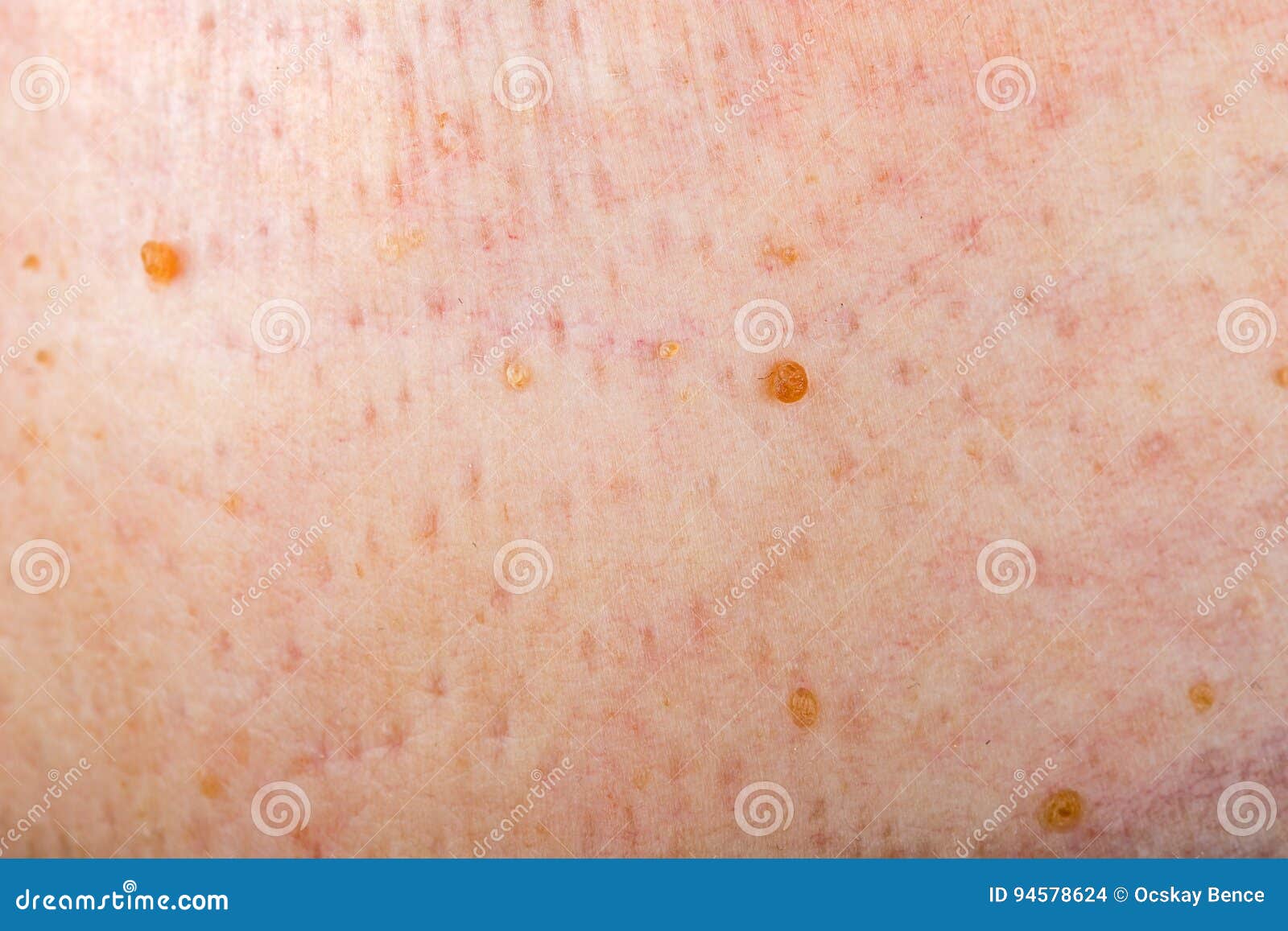 Verruche su pelle umana fotografia stock. Immagine di macro - 94578624