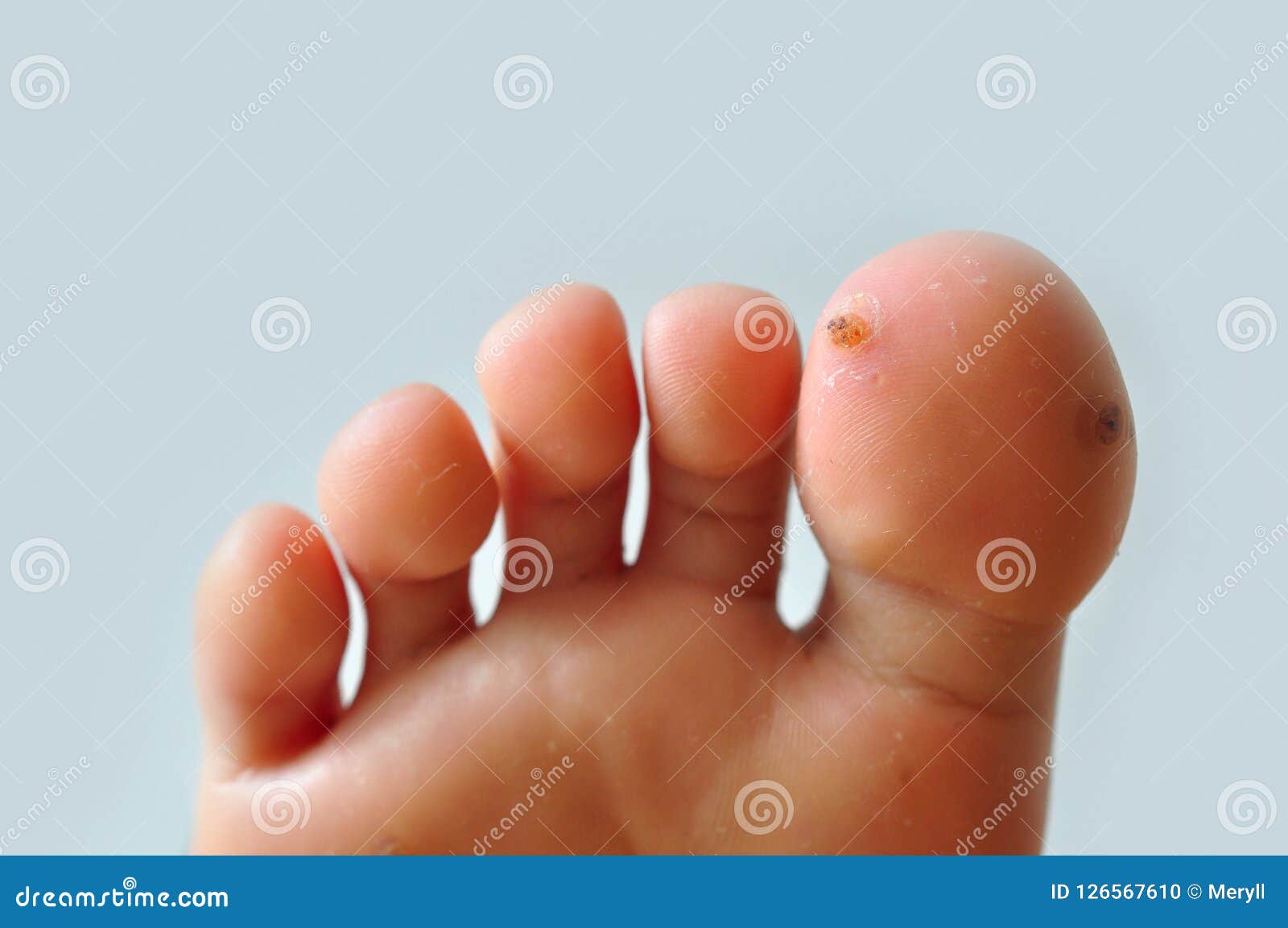 Verrue Photos Stock - Téléchargez 3,418 Photos libres de droits