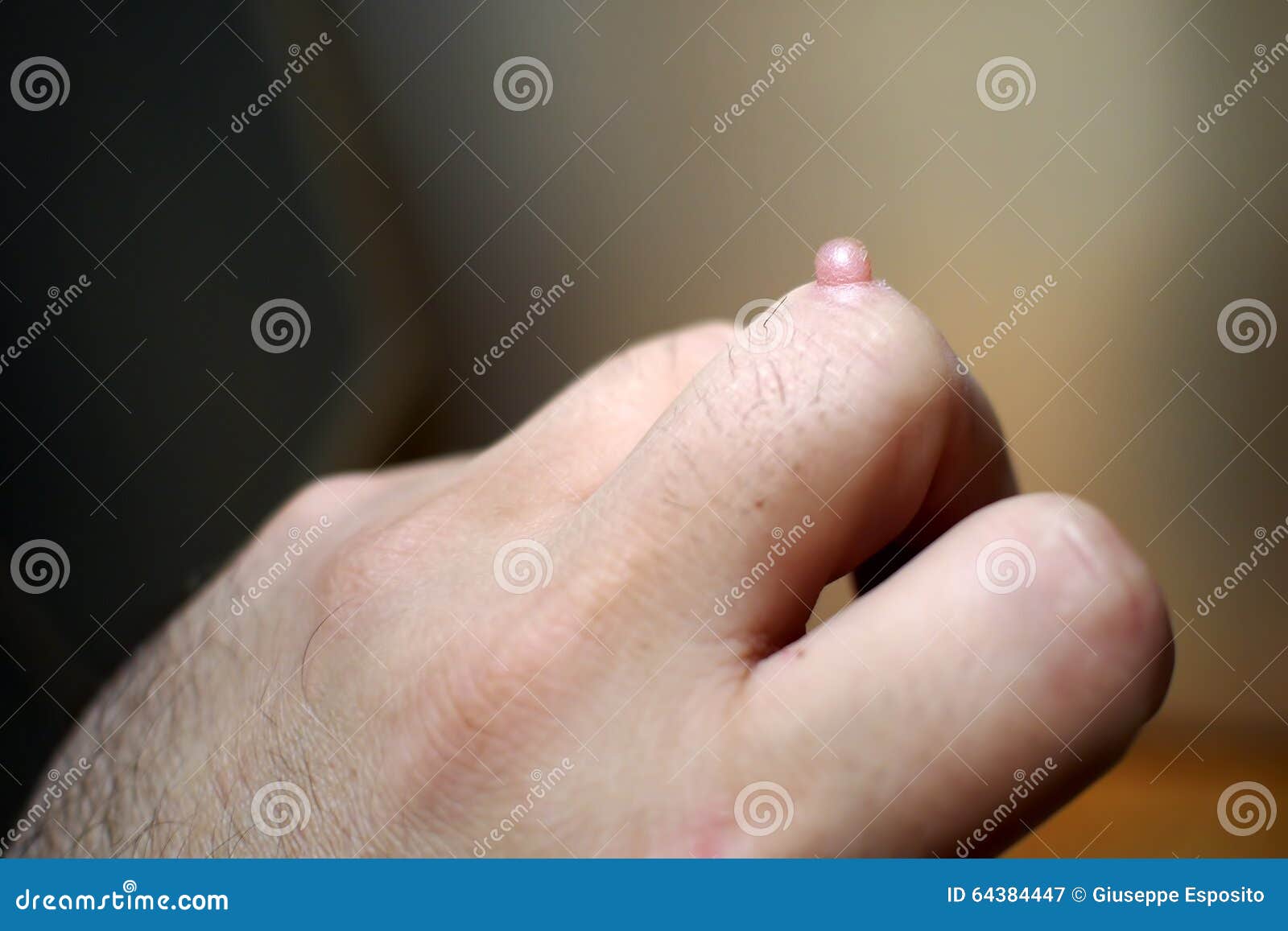 Verrue Sur Le Doigt De Main Image stock - Image du formation, peau ...