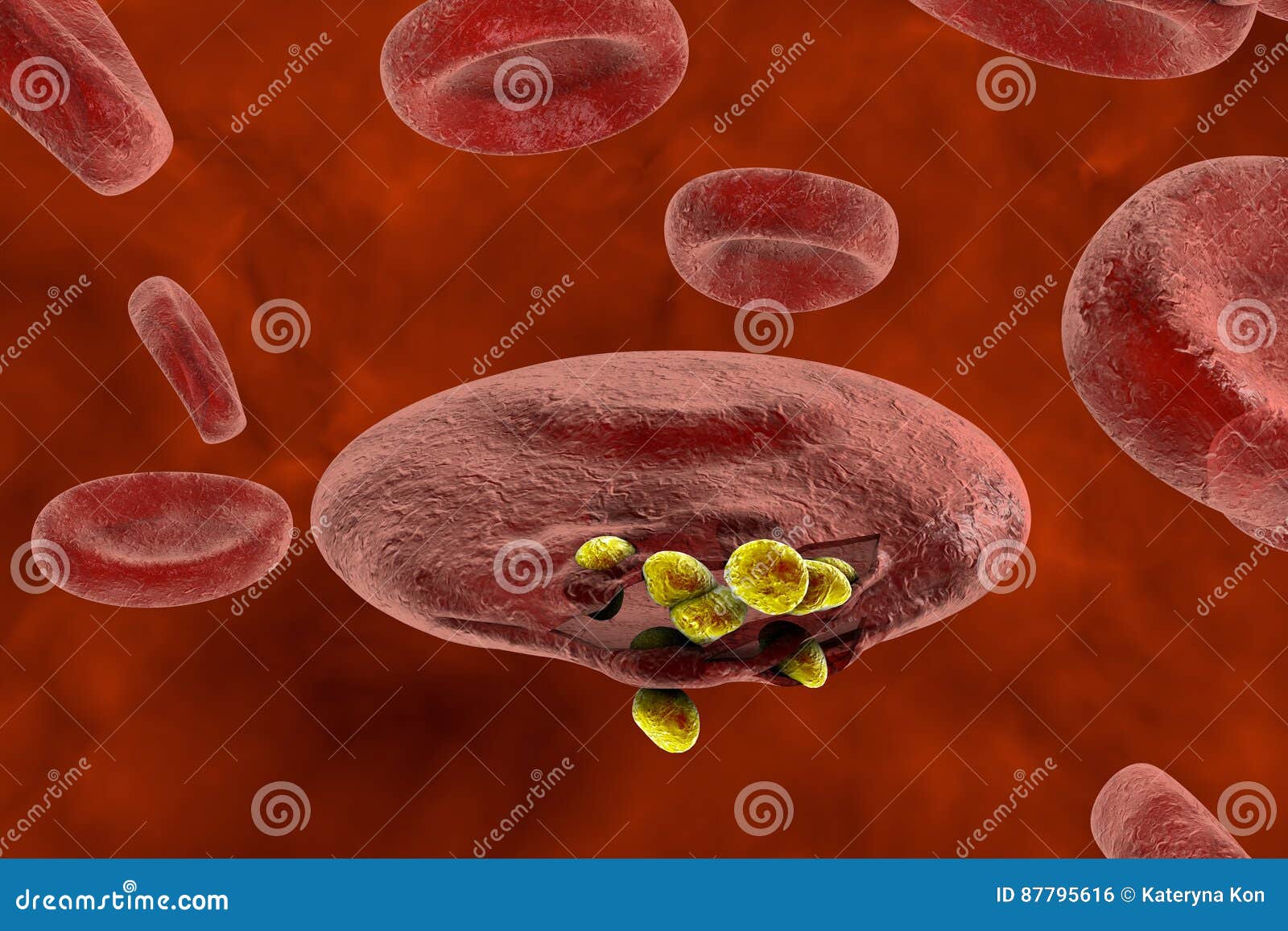Versie Van Malariaparasieten Van Rode Bloedcel Stock Illustratie ...