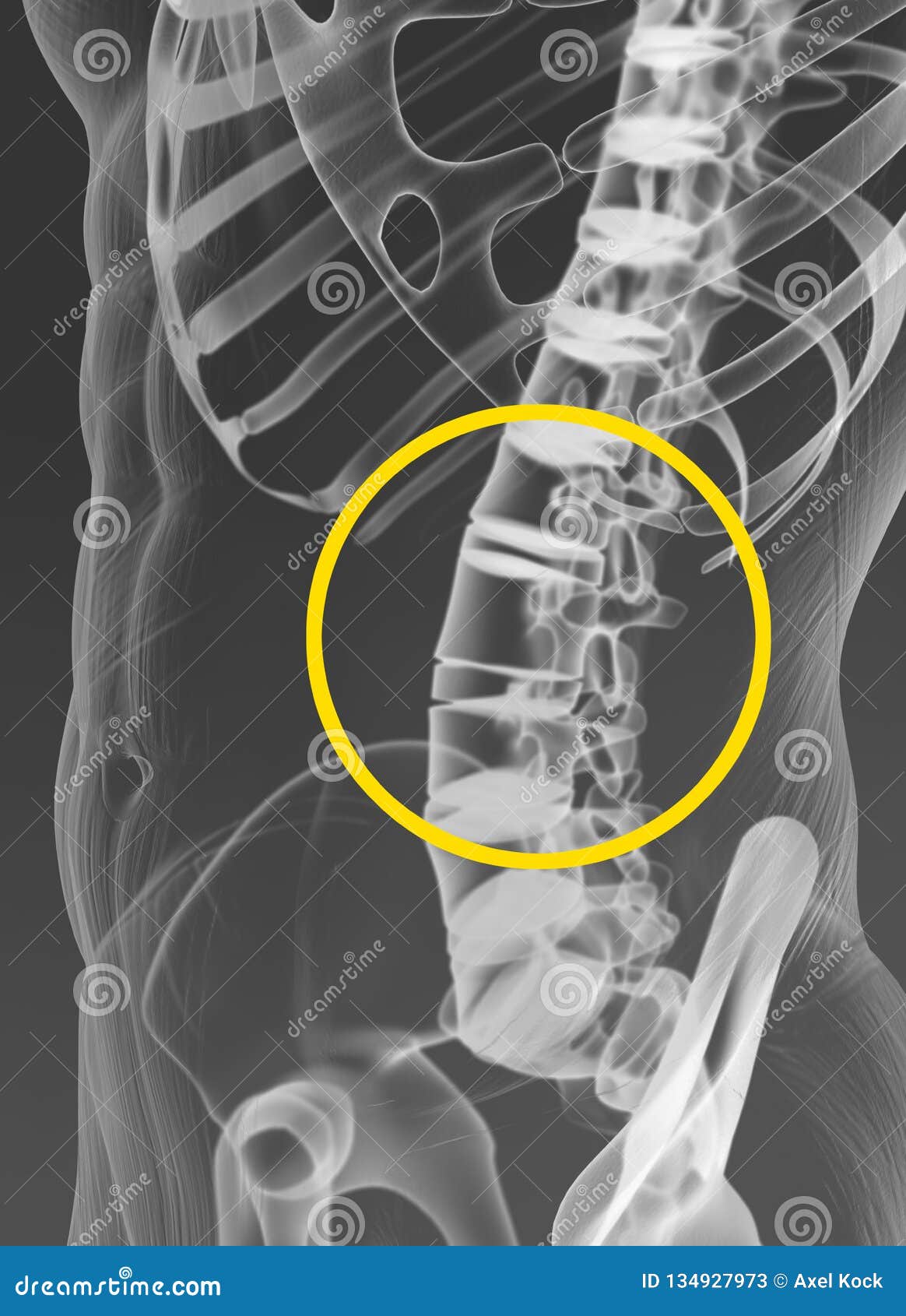 X-ray View of a Human Spine with Intervertebral Disks and Stock ...
