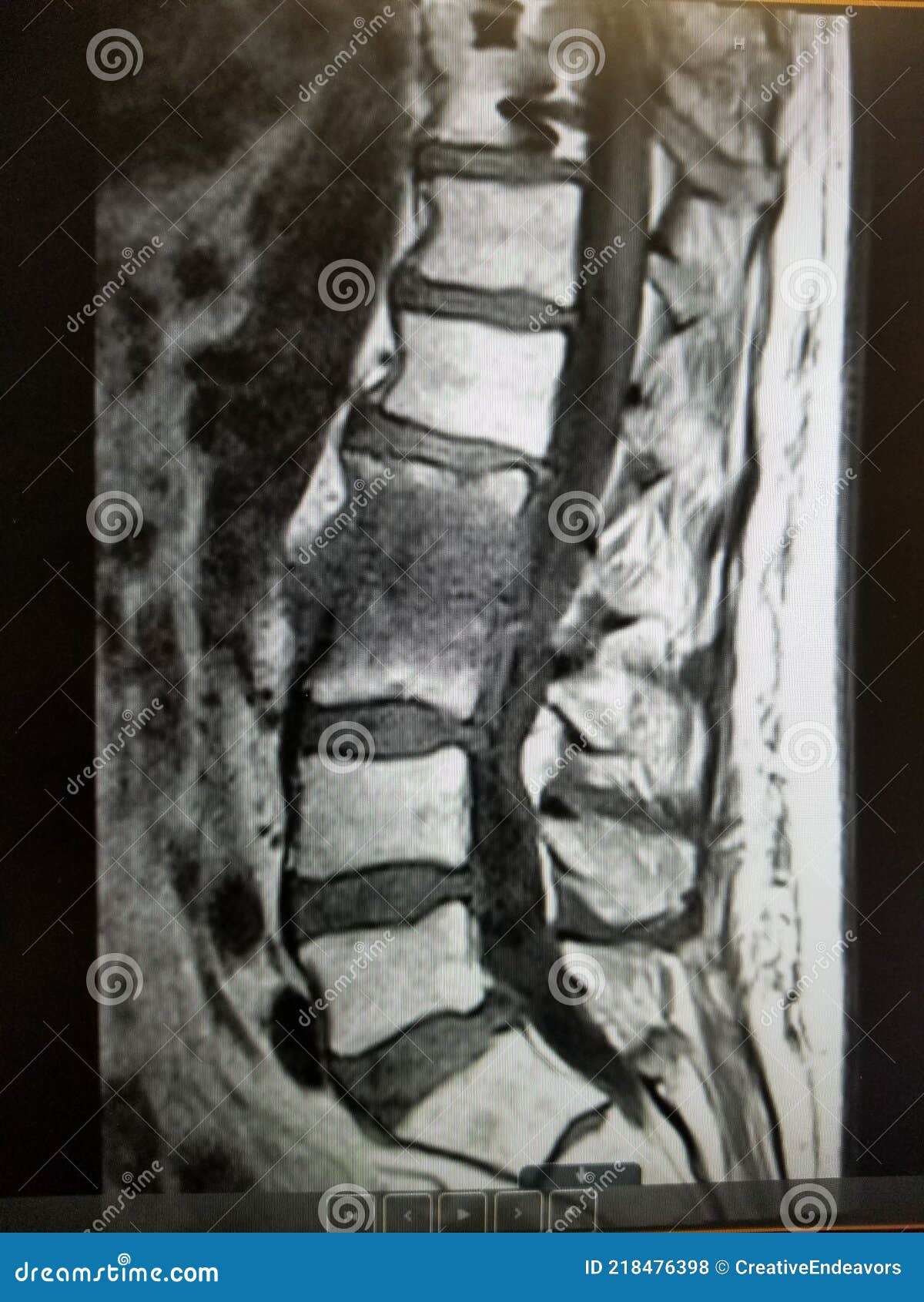 Vertebral Osteomyelitis and Discitis - Spinal Bacterial Severe ...