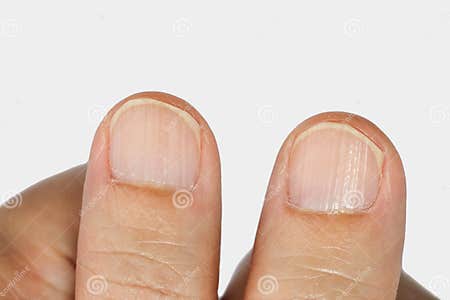 Vertical Ridges on the Fingernails Stock Image - Image of finger, zinc ...