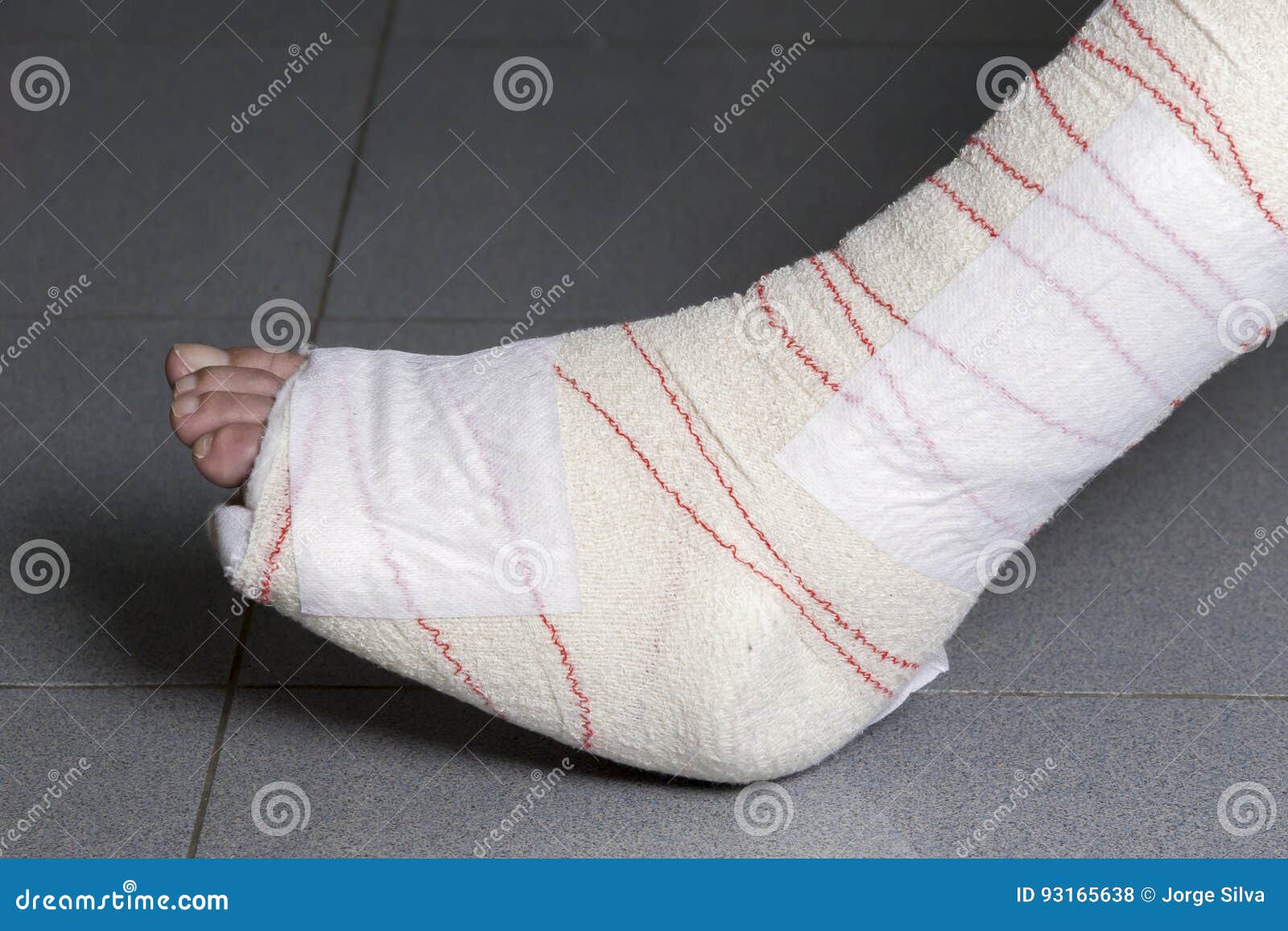 Verwondingen van pees stock foto. Image of zorg, apparatuur - 93165638