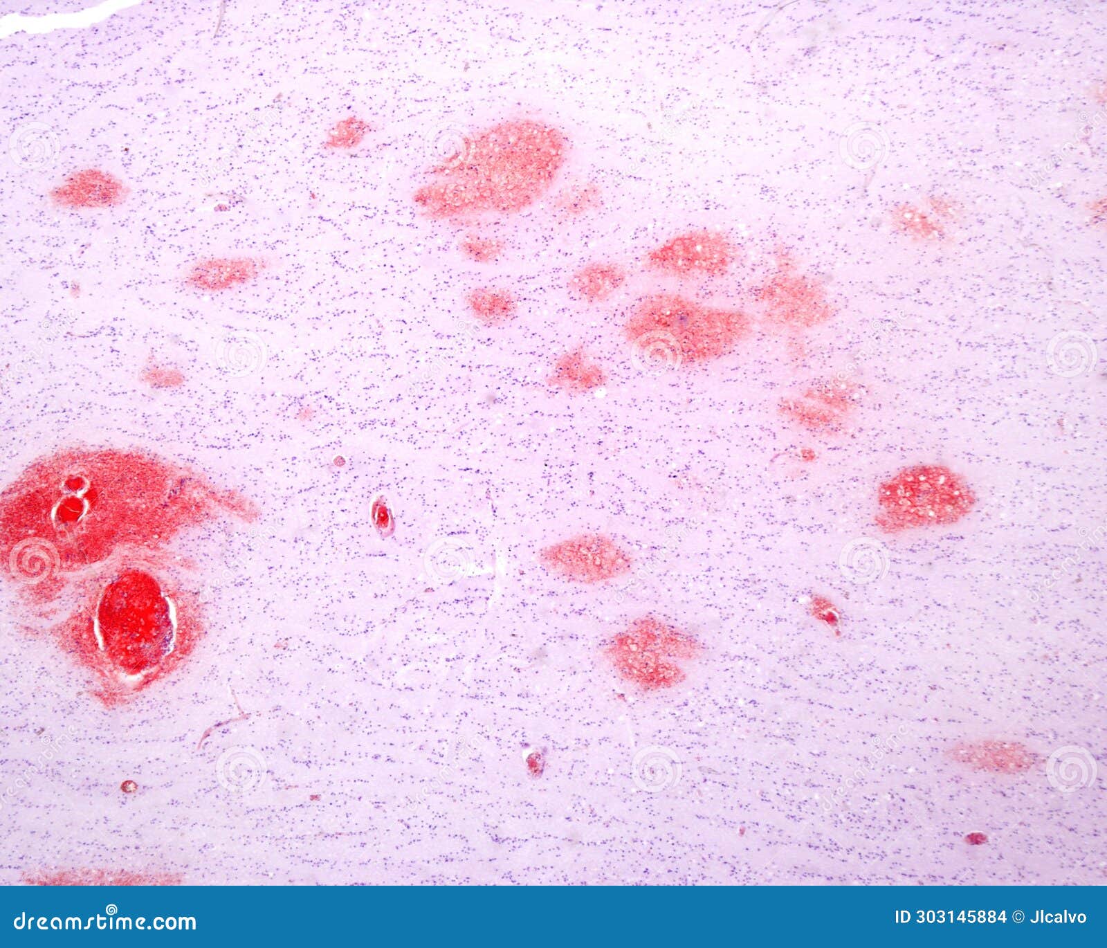 Cerebral microhemorrhages stock photo. Image of body - 303145884