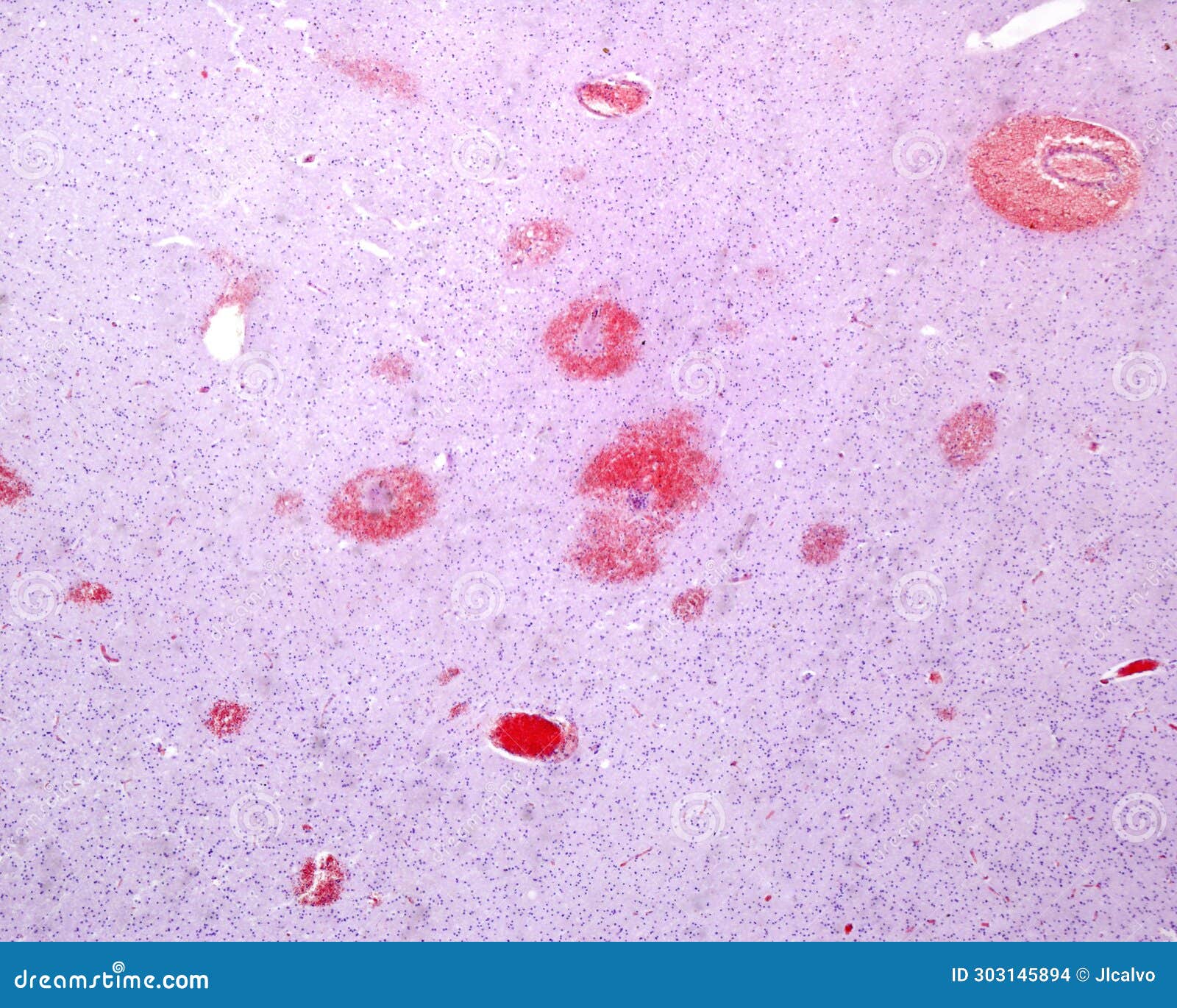 Cerebral microhemorrhages stock photo. Image of medical - 303145894