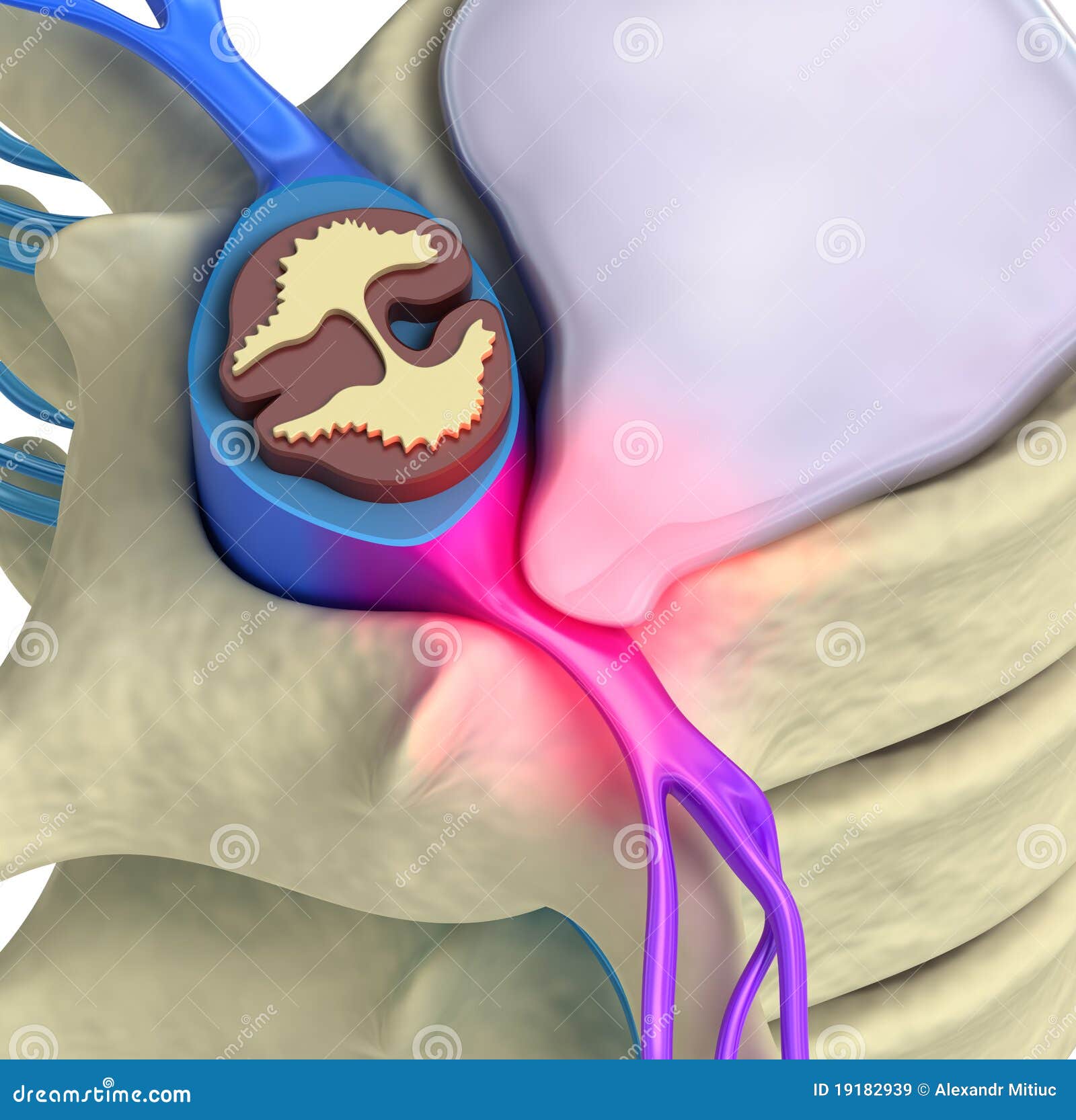 Verzakking Van Tussenwervelschijf Stock Illustratie - Illustration of ...