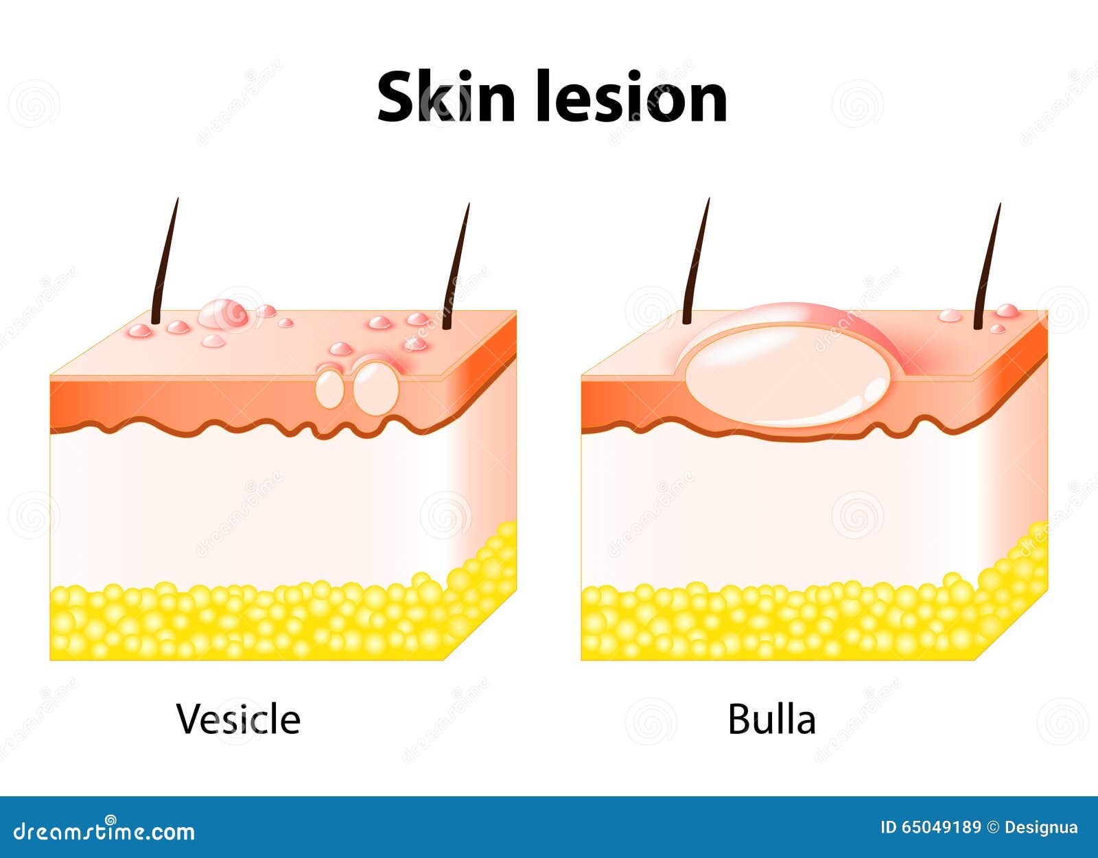 Vesícula Y Ampolla Lesión De Piel Ilustración del Vector - Ilustración ...