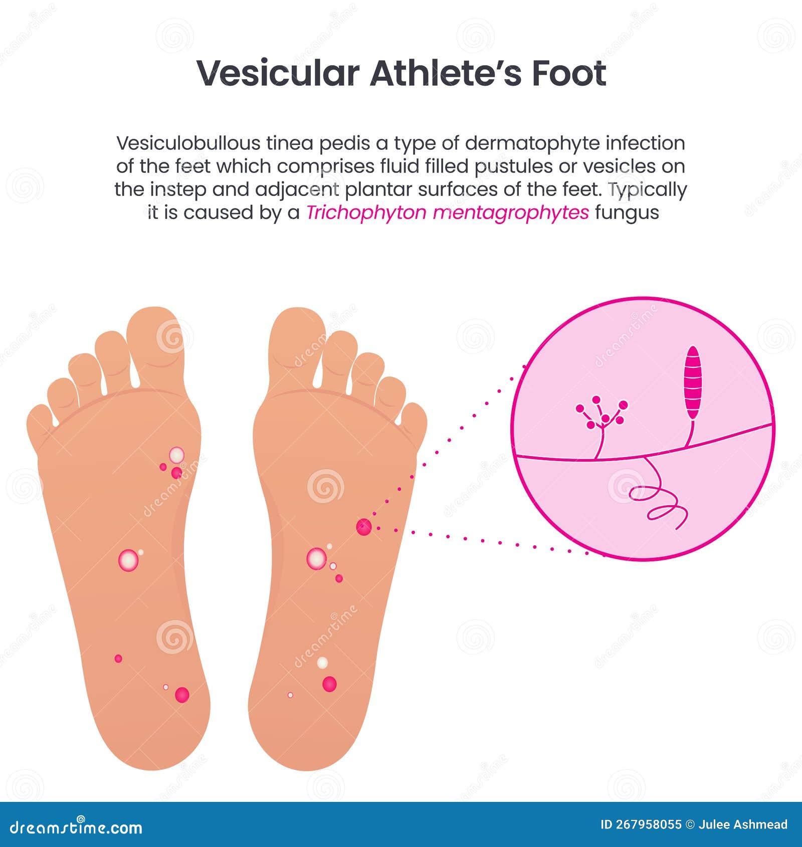 Vesicular Athlete S Foot Educational Vector Infographic Stock Vector ...