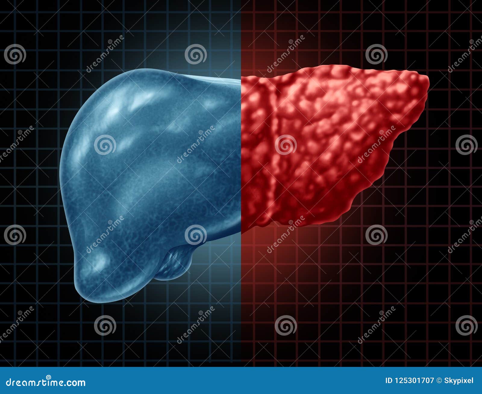 Vettige Leverziekte stock illustratie. Illustration of kwabben - 125301707