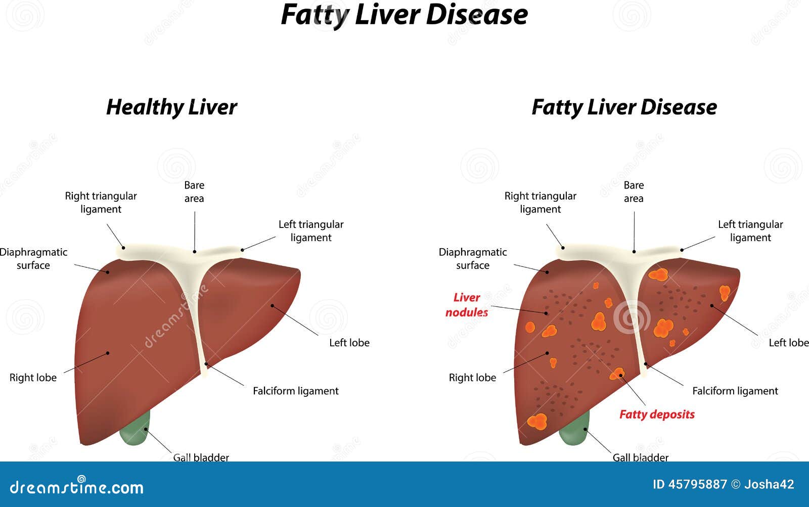 Vettige Leverziekte vector illustratie. Illustration of kwab - 45795887