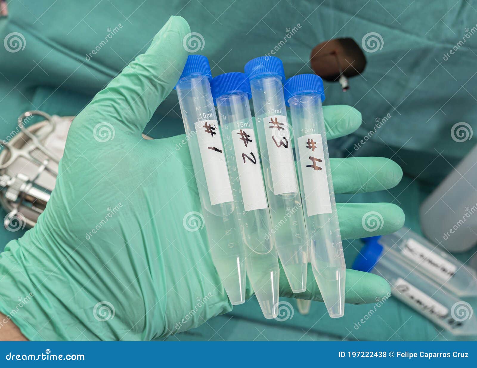 Vials with Four Samples of Cerebrospinal Fluid in Patients with ...