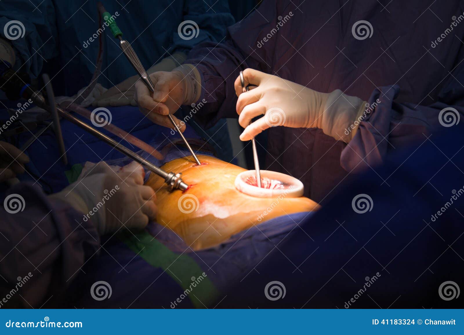Video assist thoracotomy stock photo. Image of lamp, procedure - 41183324