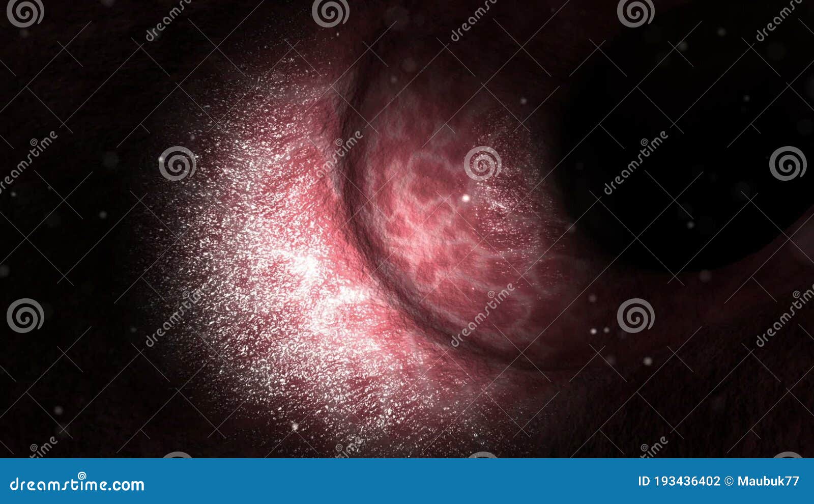 Polypectomy Cartoons, Illustrations & Vector Stock Images - 53 Pictures ...