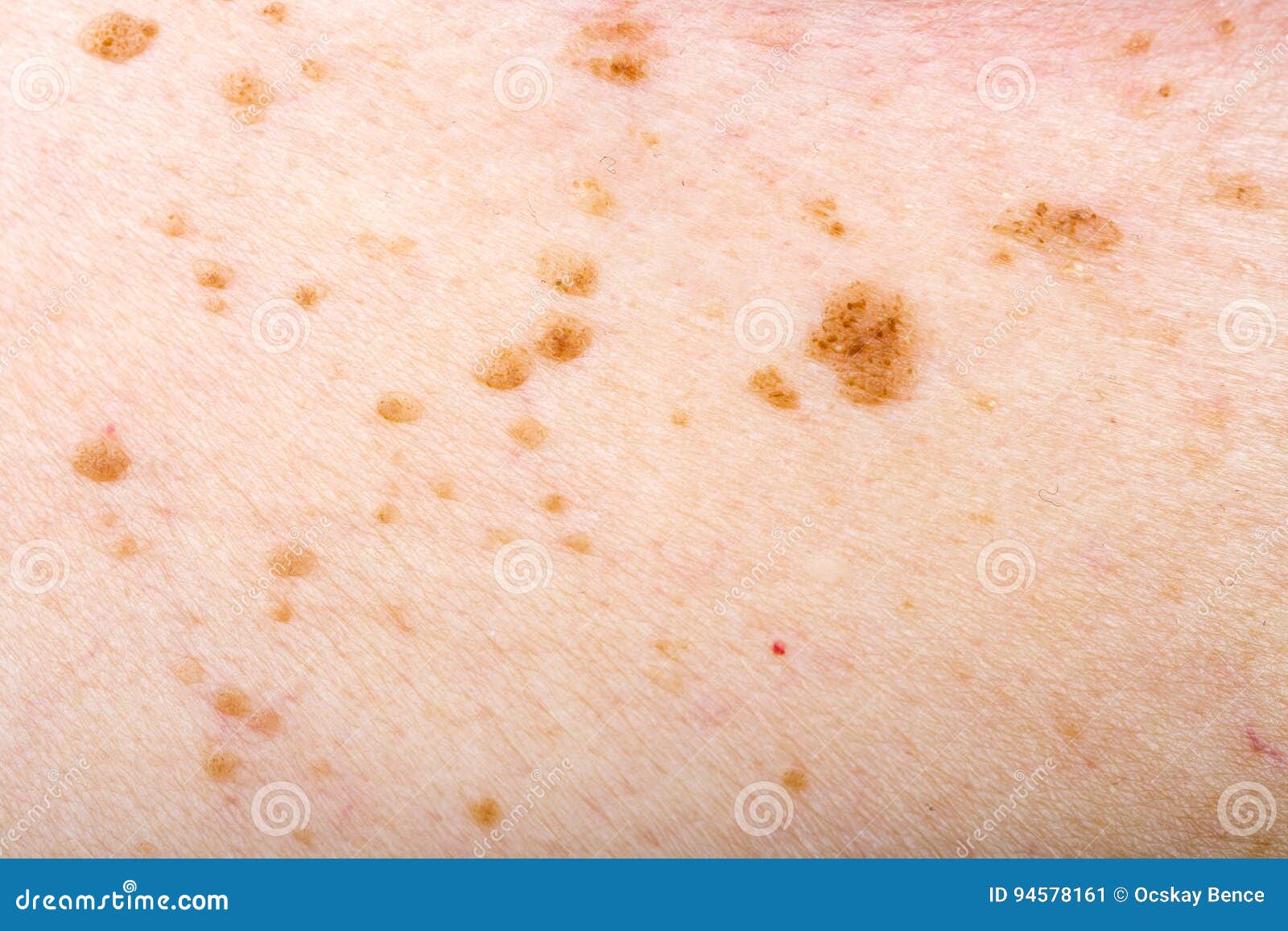 Viel Muttermal Auf Menschlicher Haut Stockbild - Bild von gesundheit ...