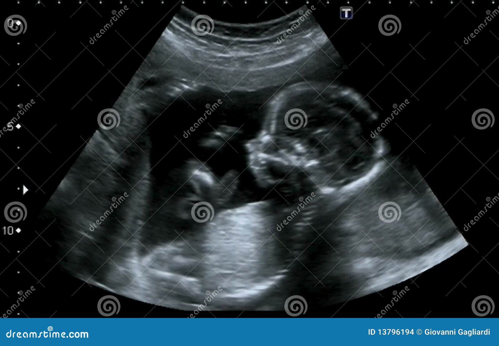 Vierde Maand Echography stock foto. Image of sonogram - 13796194