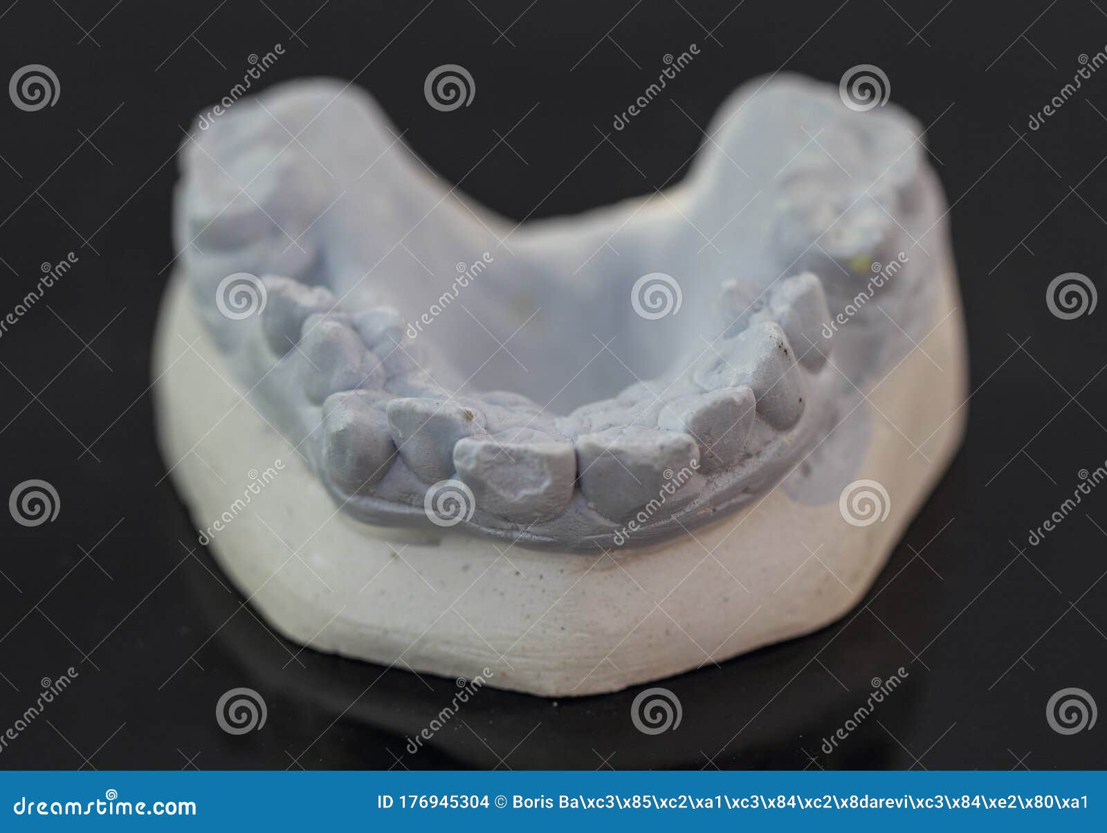 View of Plaster Model of Lower Front Teeth Stock Photo - Image of ...