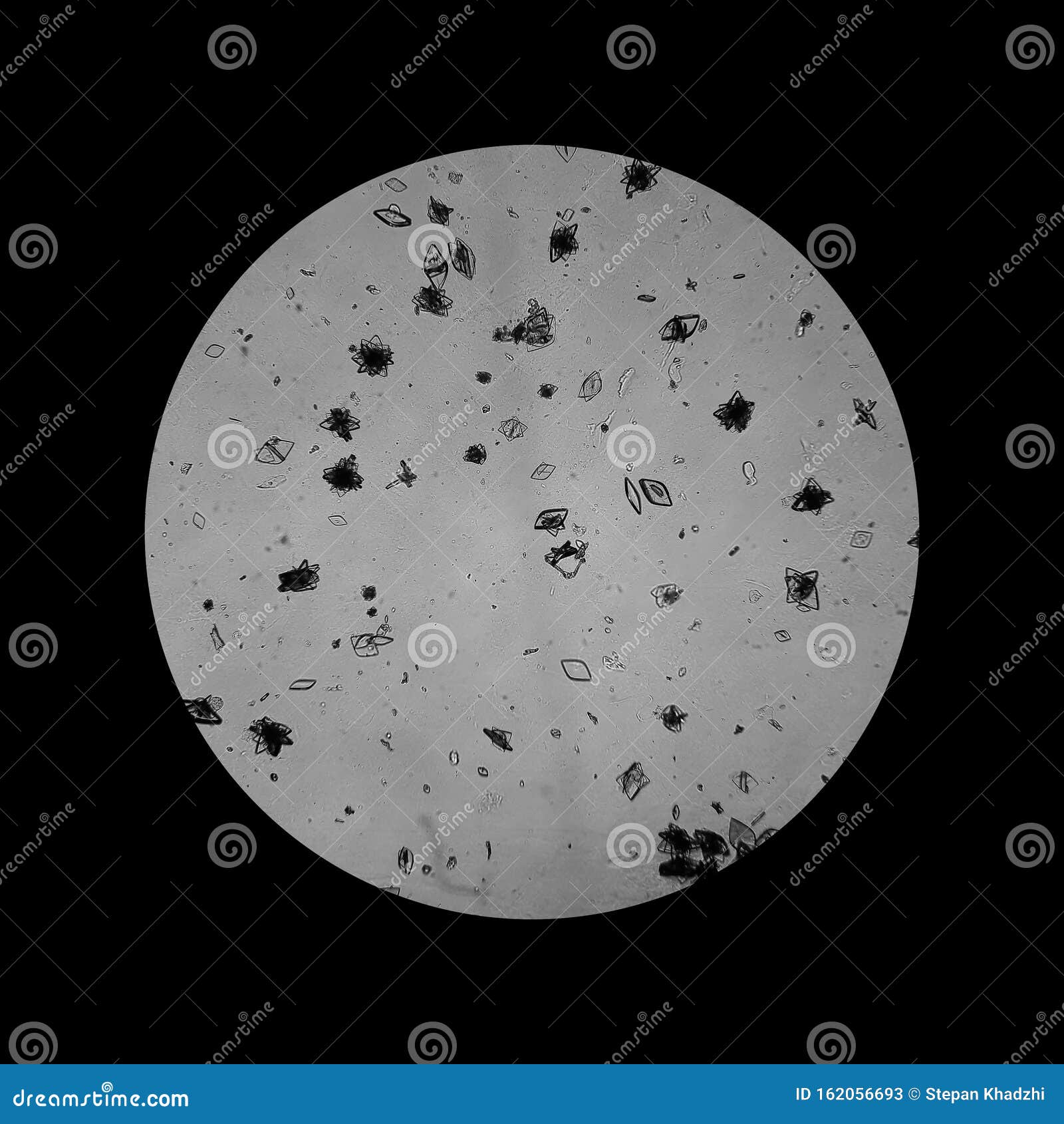 Uric Acid Kidney Stones Microscopic