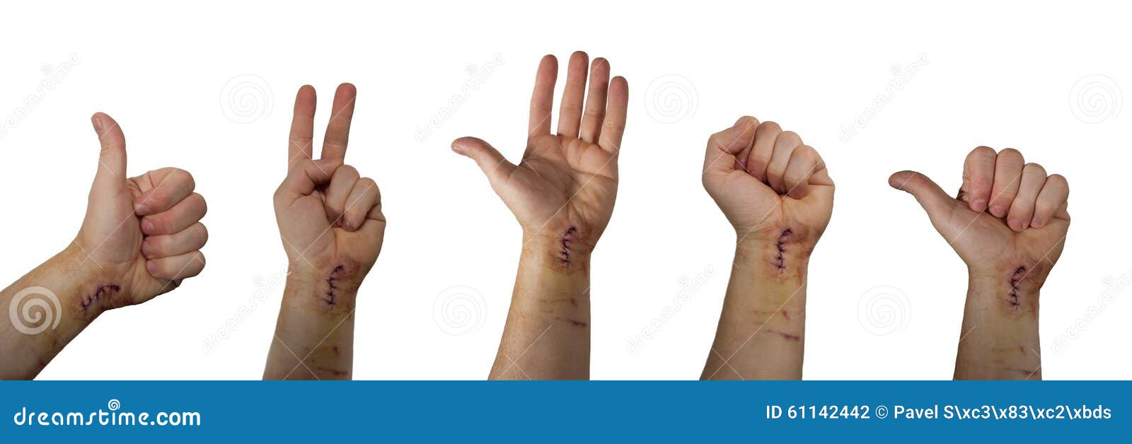 Views of the Hand with Fresh Scar Stock Photo - Image of surgery ...