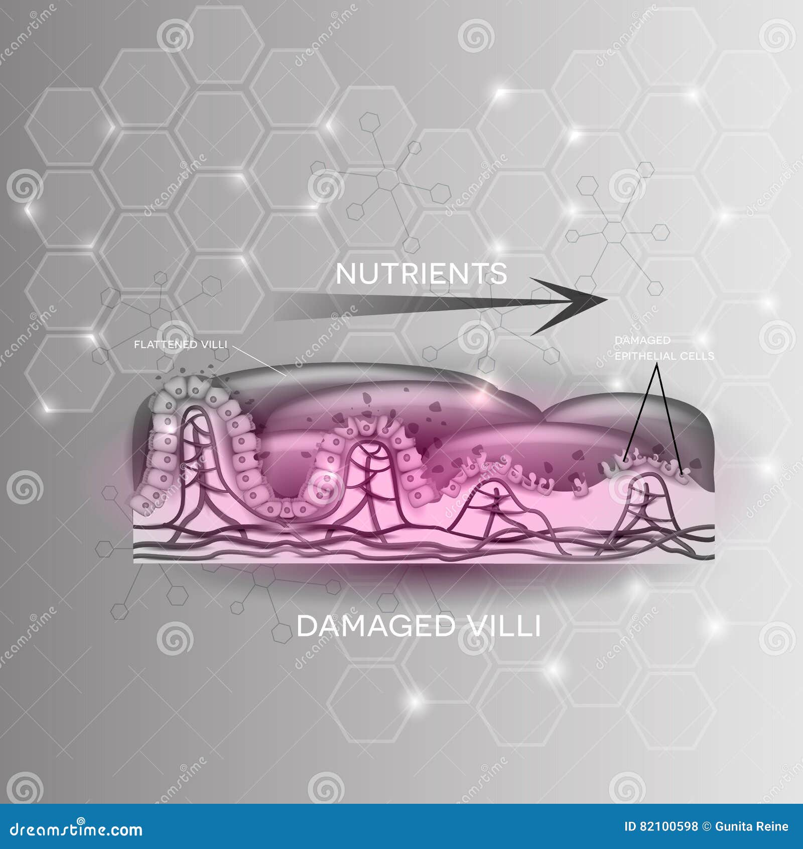 Villi Intestinais Danificados Ilustração do Vetor - Ilustração de dano ...