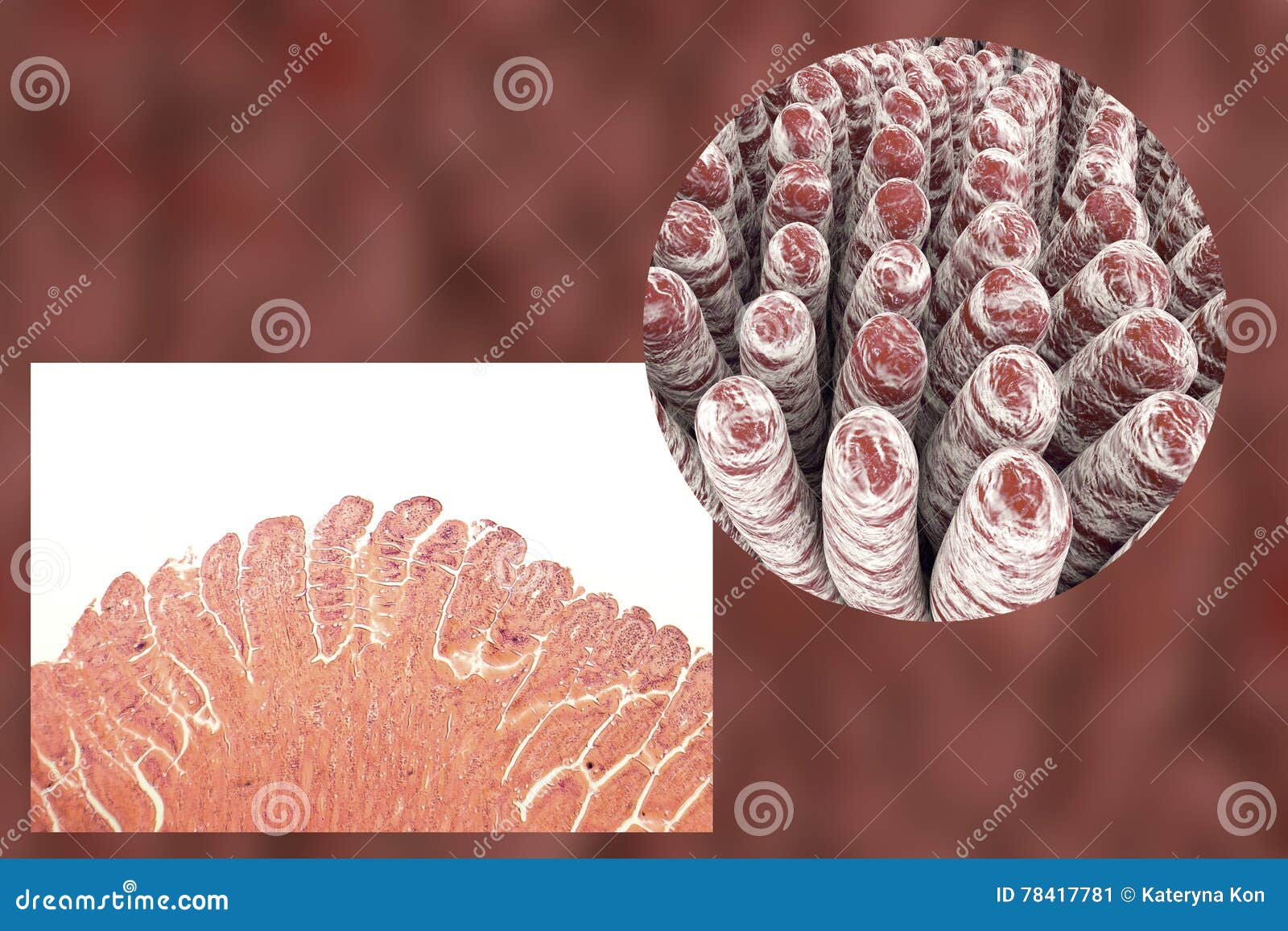 Villi of small intestine stock illustration. Illustration of disease ...